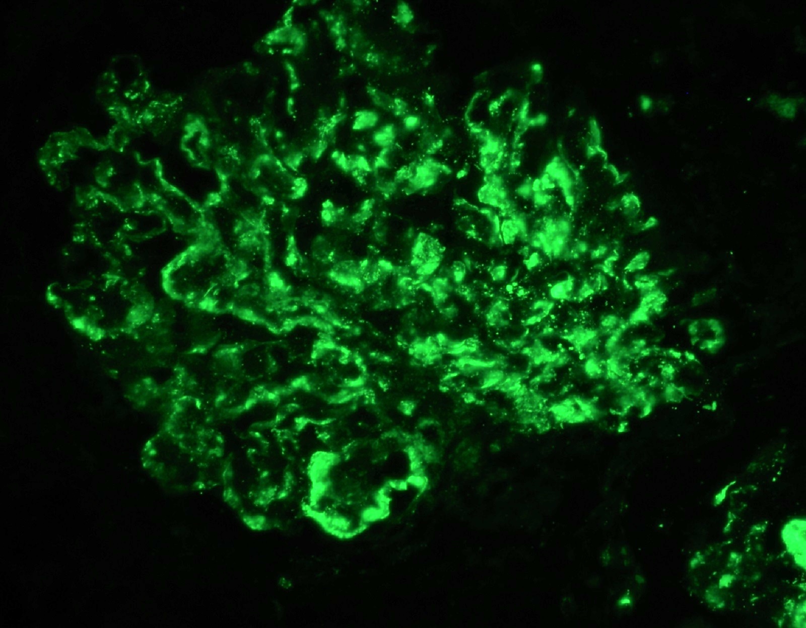 Pathology Outlines - Crescentic glomerulonephritis overview