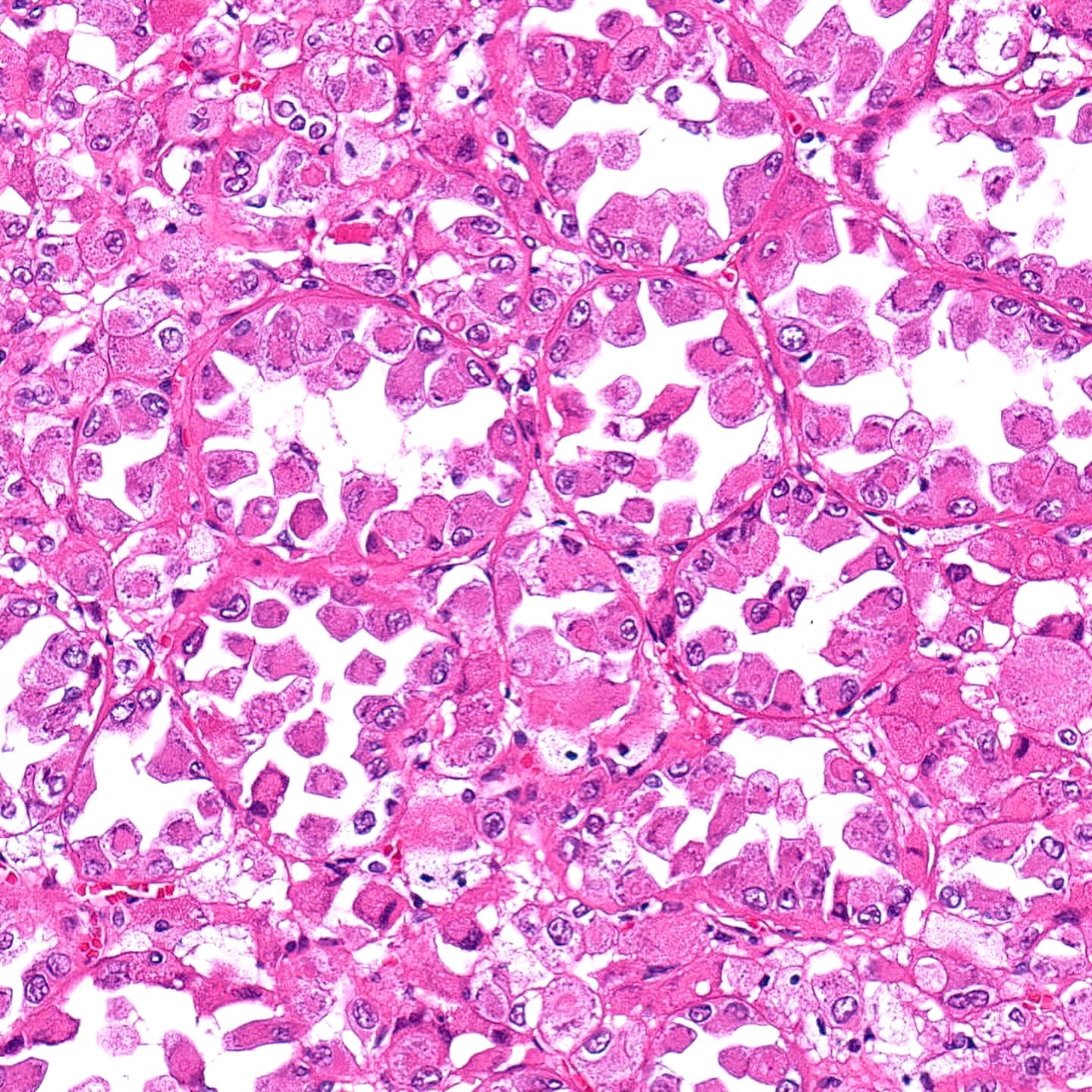 Pathology Outlines Eosinophilic Cystitis The Histological Features