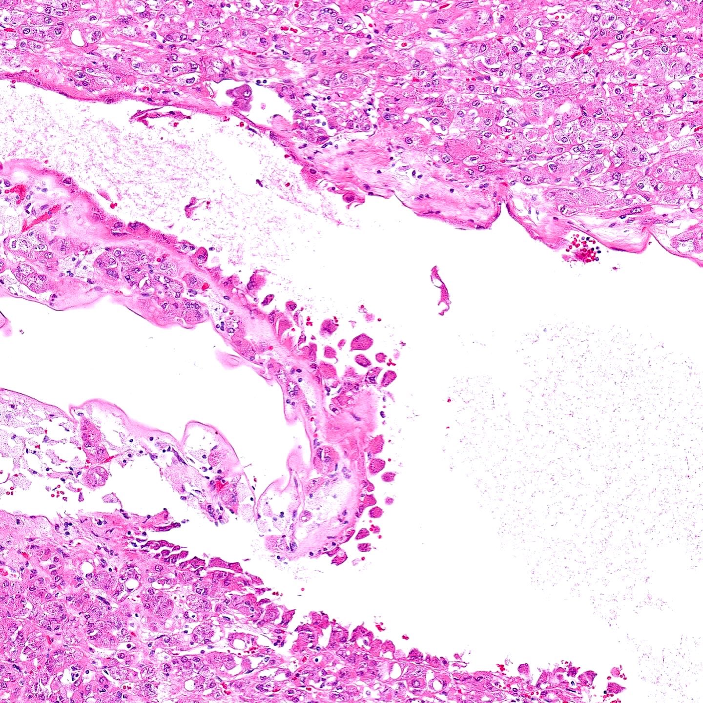 Pathology Outlines Eosinophilic Cystitis The Histological Features