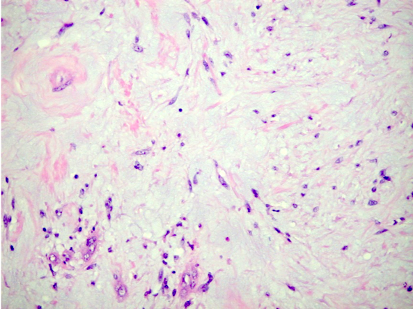 Interstitial Cells Kidney