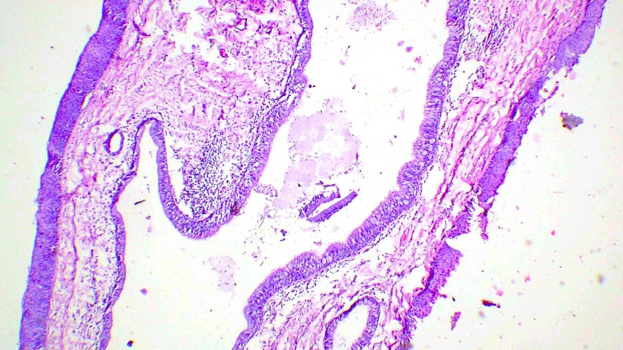 Pathology Outlines - Laryngeal cysts