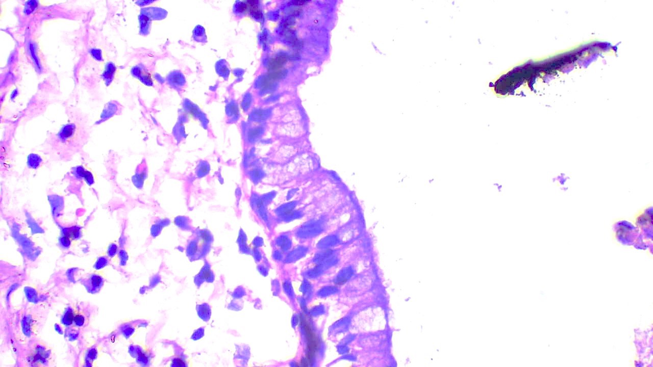 Pathology Outlines - Laryngeal cysts