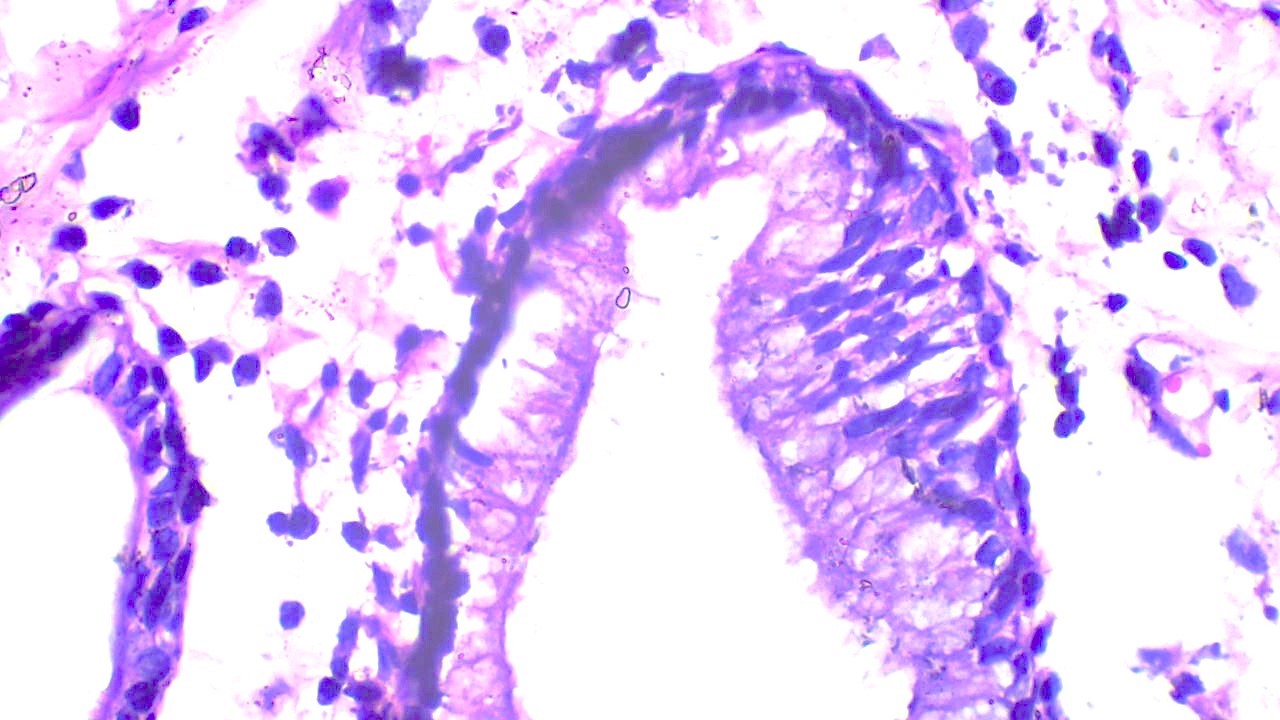 Pathology Outlines - Laryngeal cysts