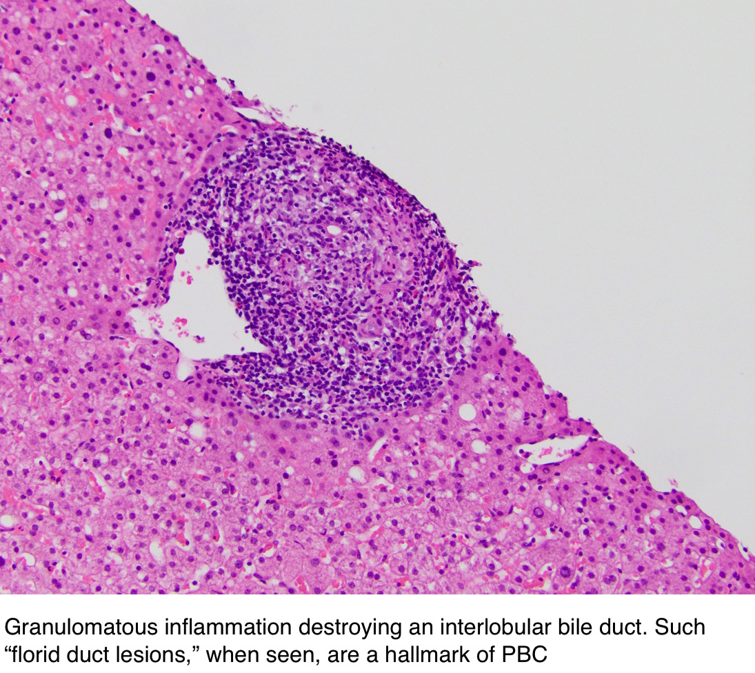 Pathology Outlines - Primary biliary cholangitis