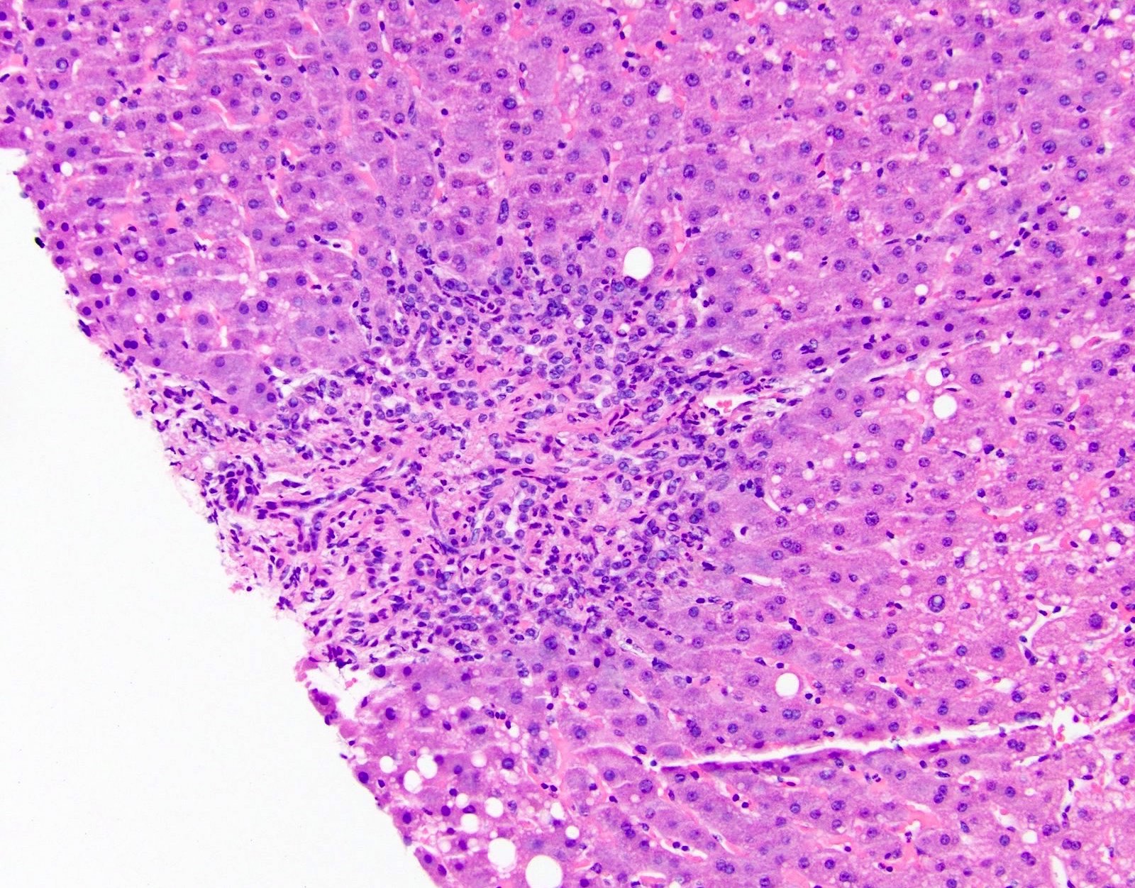 Pathology Outlines - Large duct obstruction
