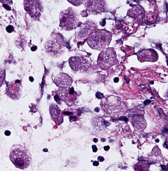 Pathology Outlines - Entamoeba histolytica abscess