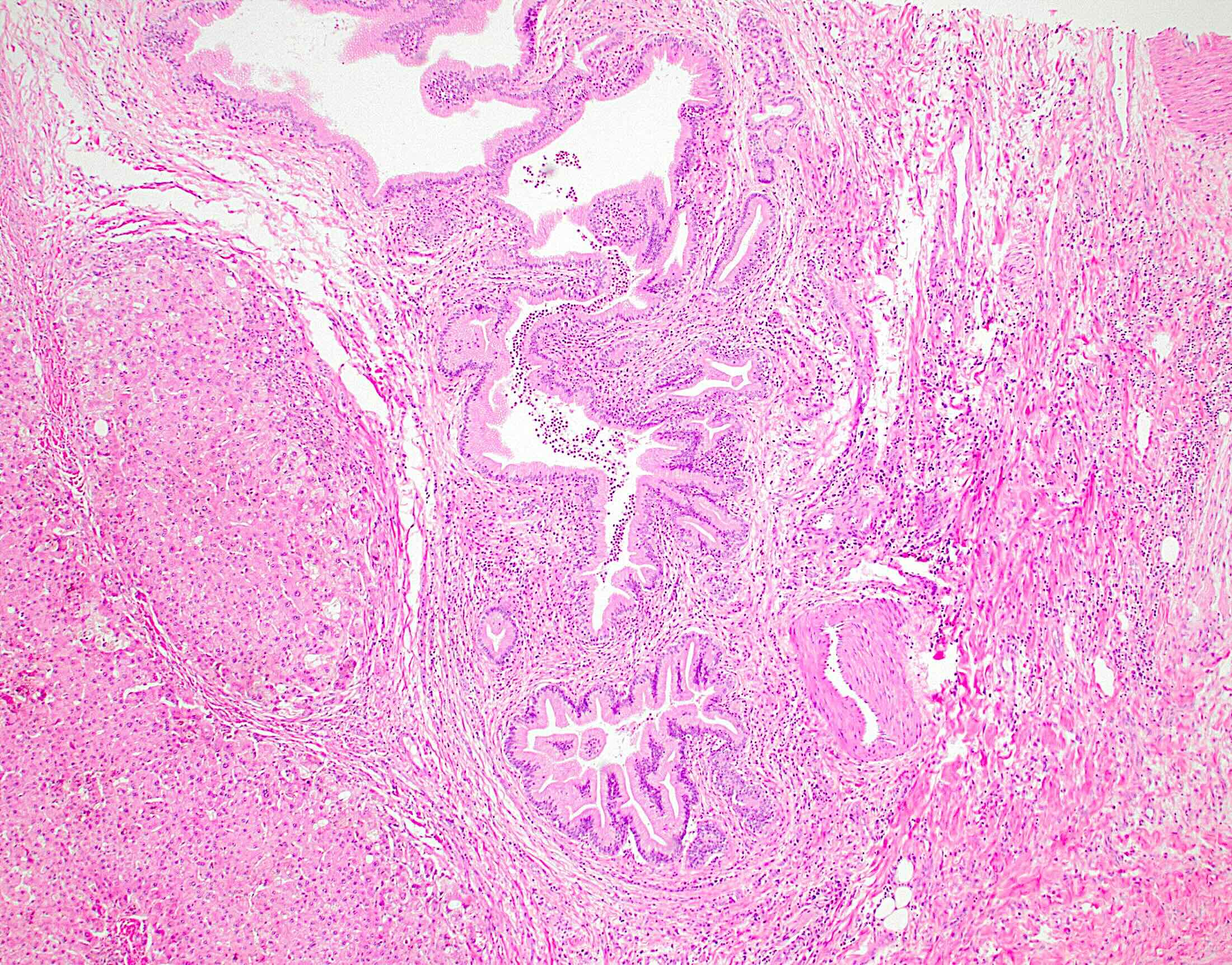 Pathology Outlines - Ascending cholangitis