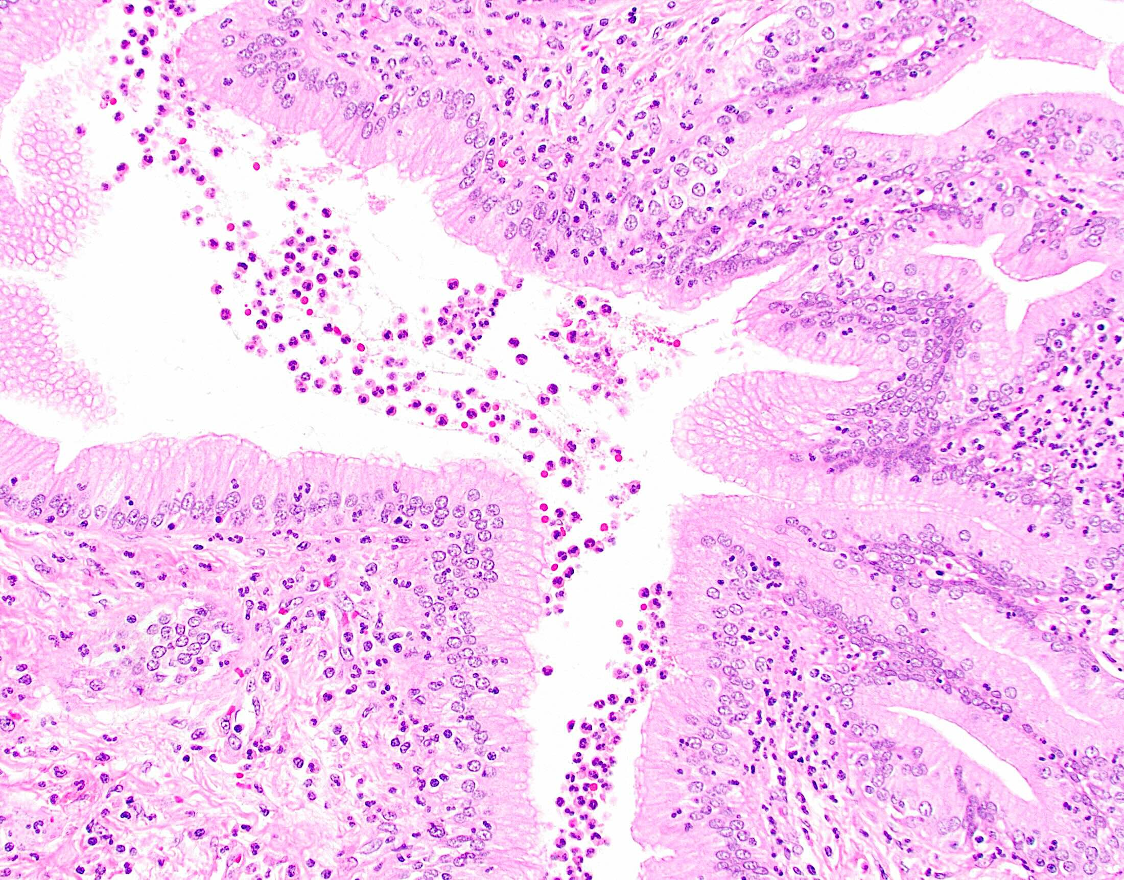 Pathology Outlines - Ascending cholangitis