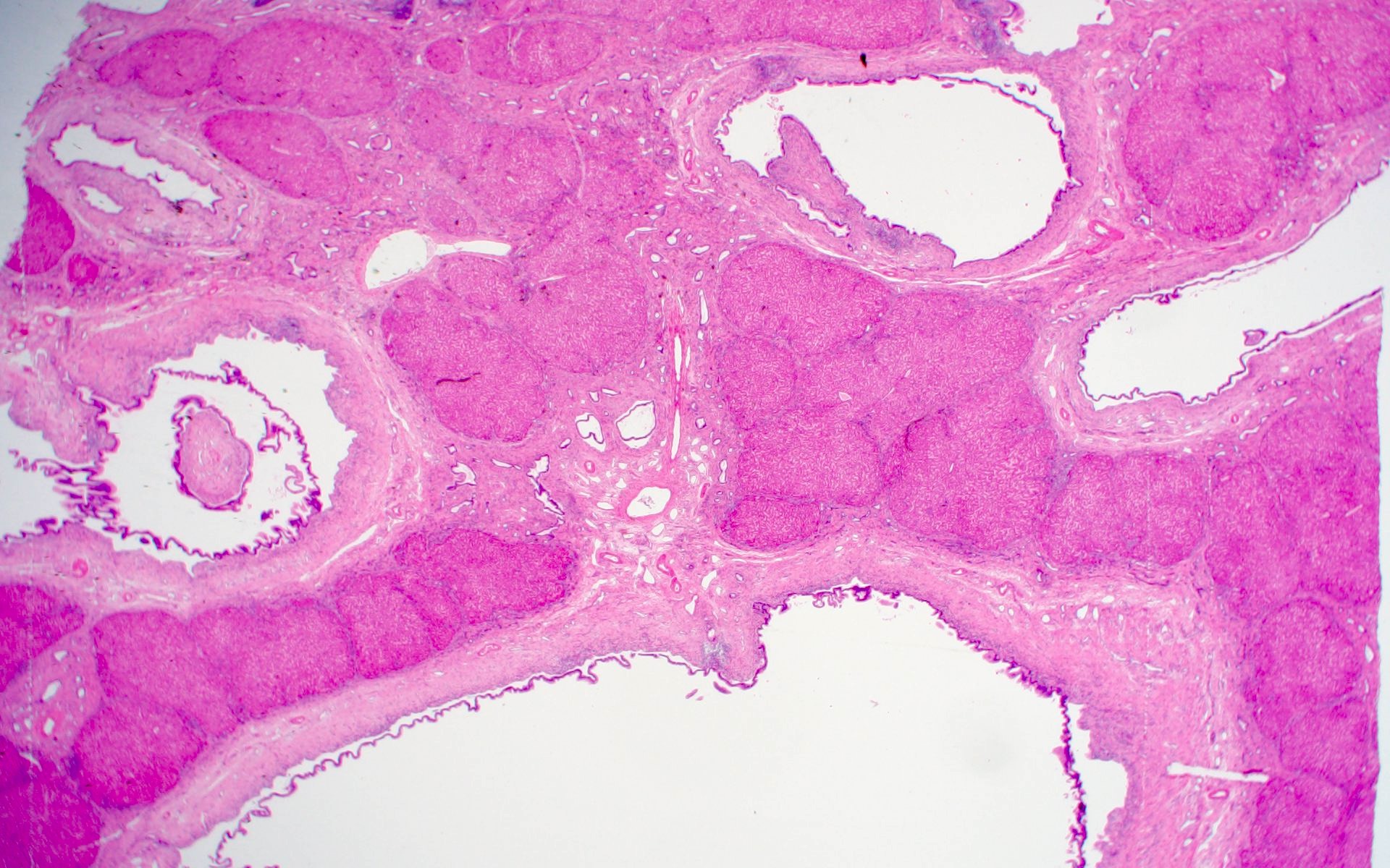 Pathology Outlines - Caroli disease