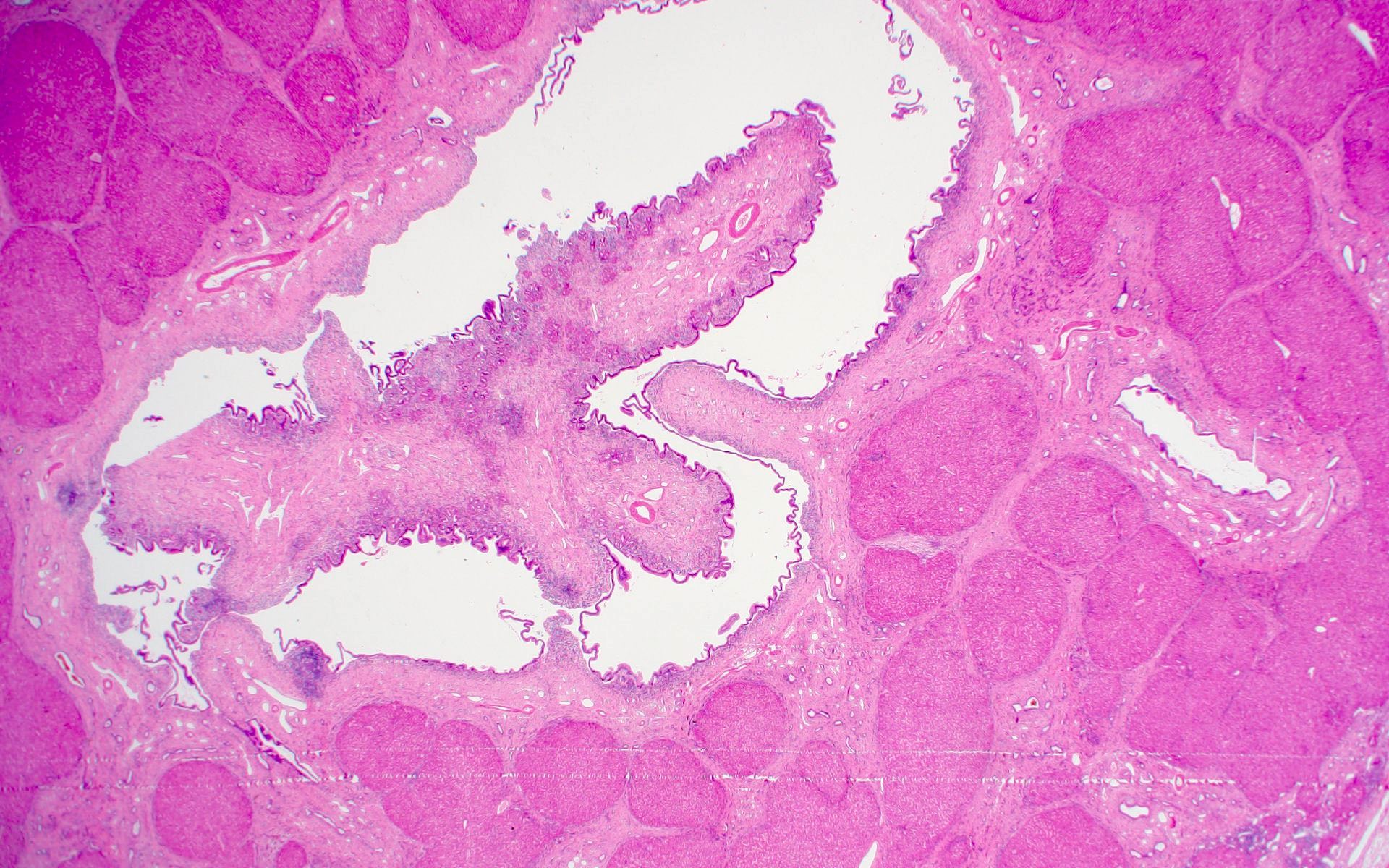 Pathology Outlines - Caroli disease