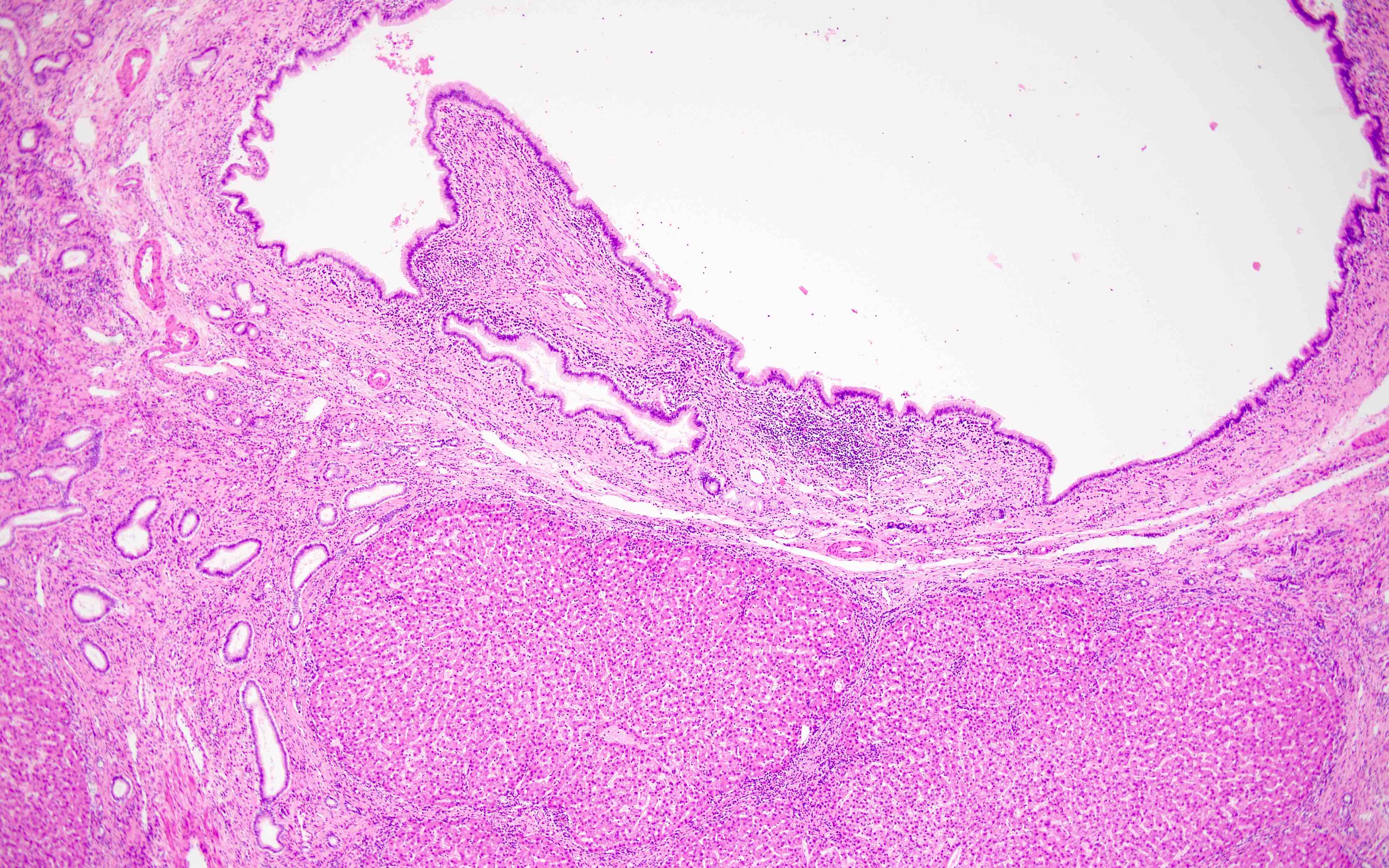 Pathology Outlines - Caroli disease
