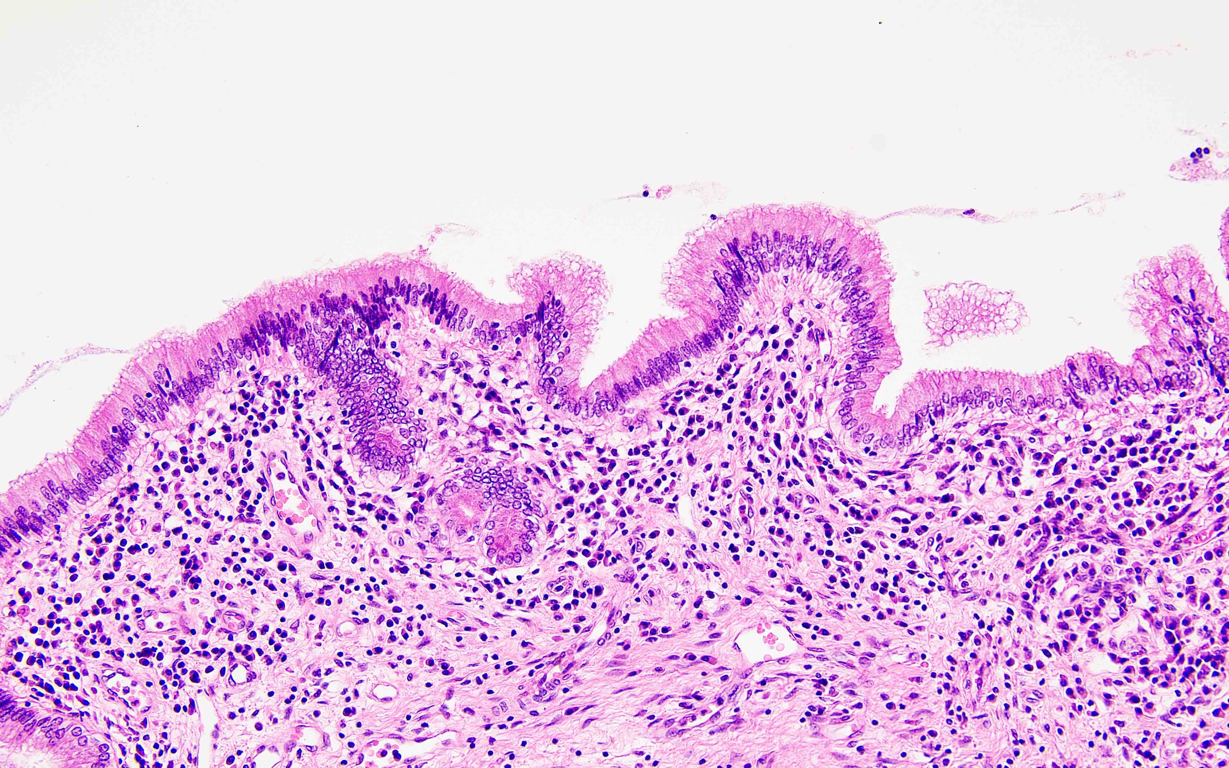Pathology Outlines - Caroli disease