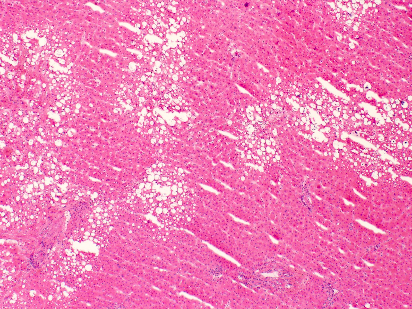 Pathology Outlines - Donor liver frozen section evaluation