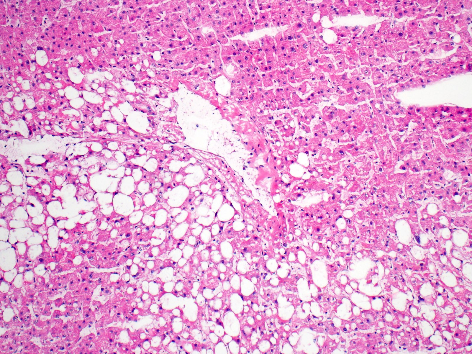 Pathology Outlines - Donor liver frozen section evaluation