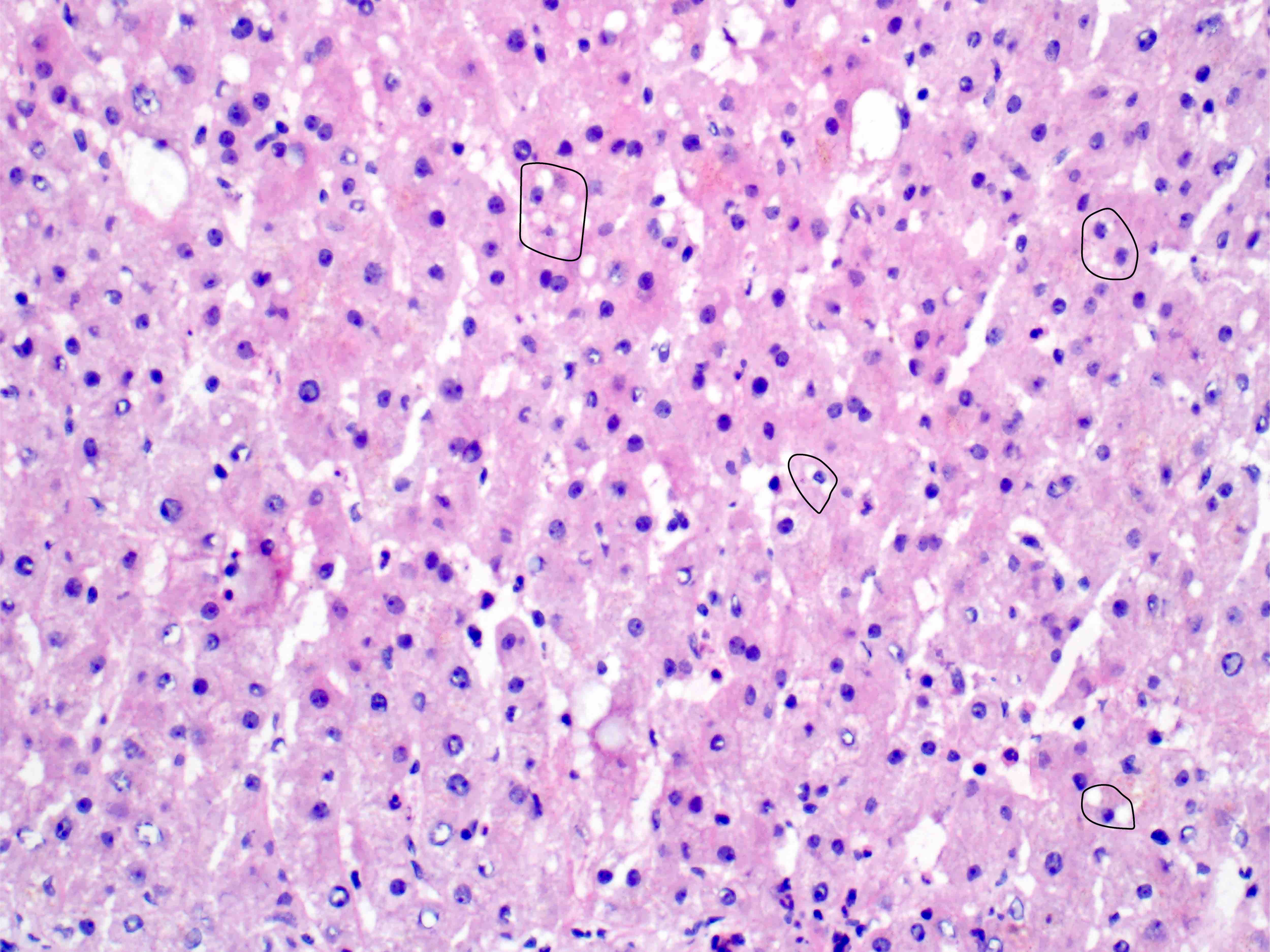 Pathology Outlines - Donor liver frozen section evaluation