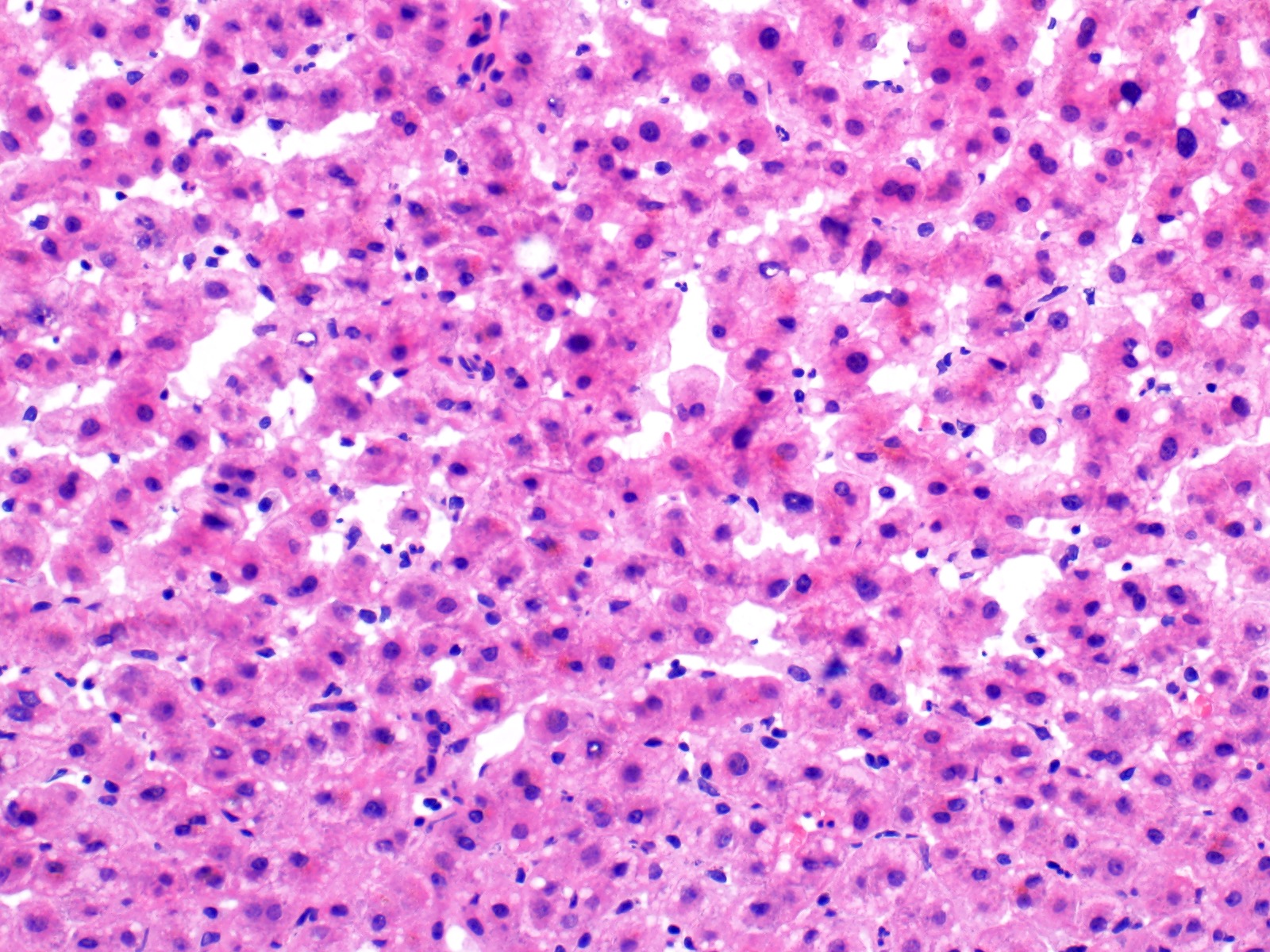 Pathology Outlines - Donor liver frozen section evaluation