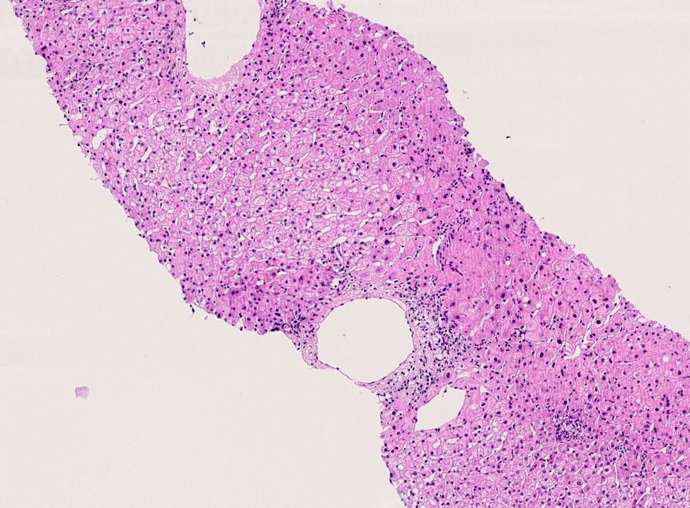 Pathology Outlines - Late T cell mediated (cellular) rejection