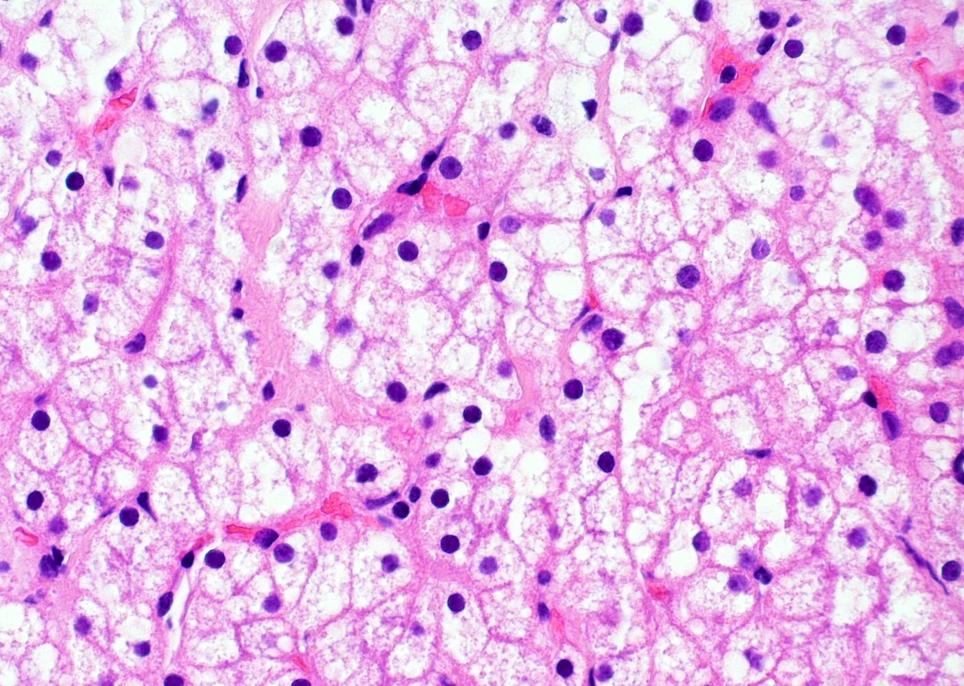 Pathology Outlines - Lysosomal acid lipase deficiency