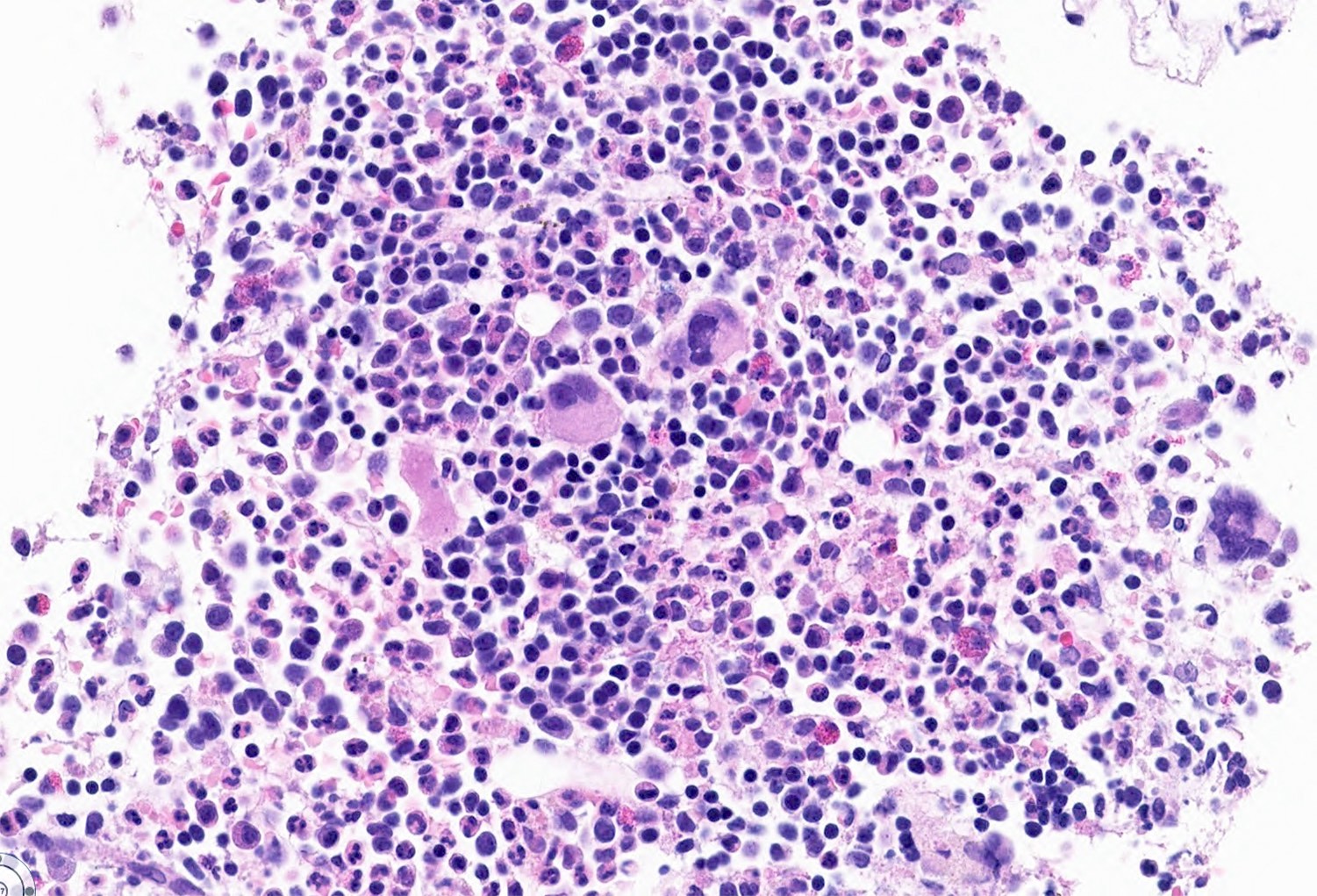 Pathology Outlines - Extramedullary hematopoiesis