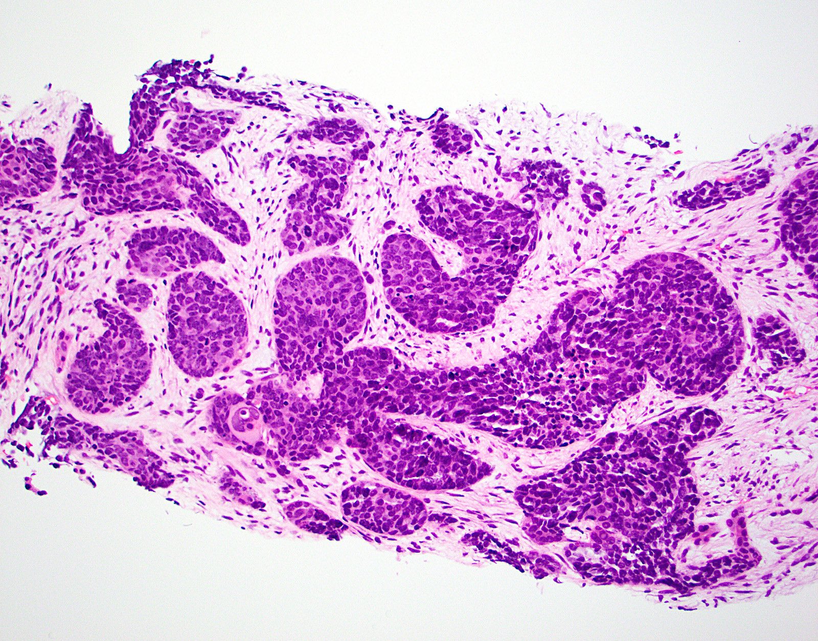 Pathology Outlines - Neuroendocrine carcinoma