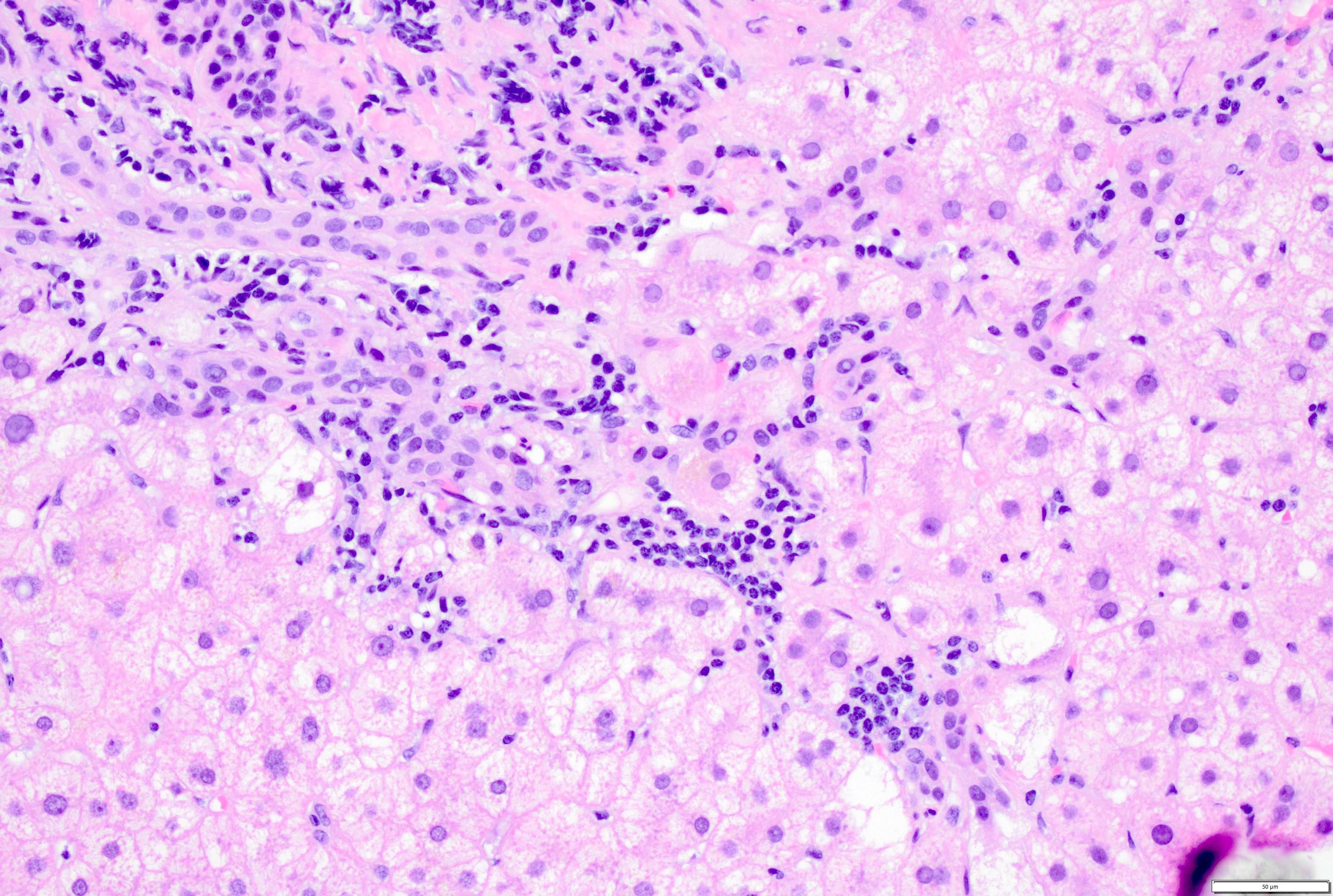 Pathology Outlines - Metastases