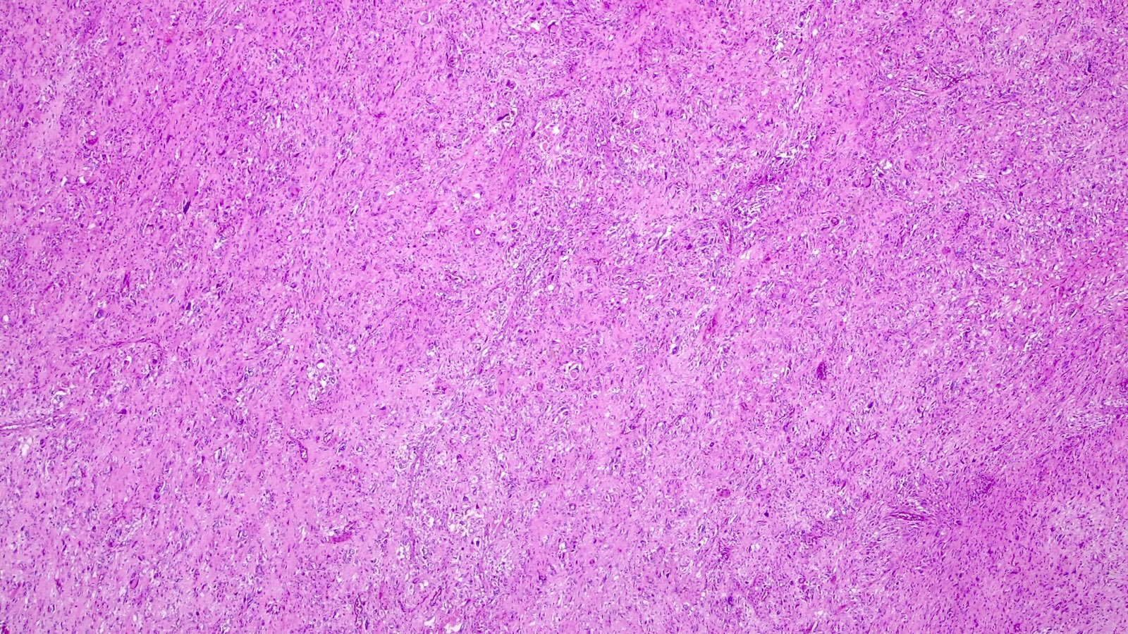 Pathology Outlines - Embryonal sarcoma of the liver