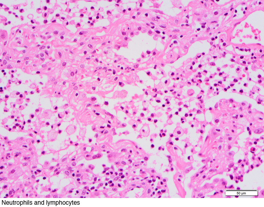 Pathology Outlines - ARDS / DAD