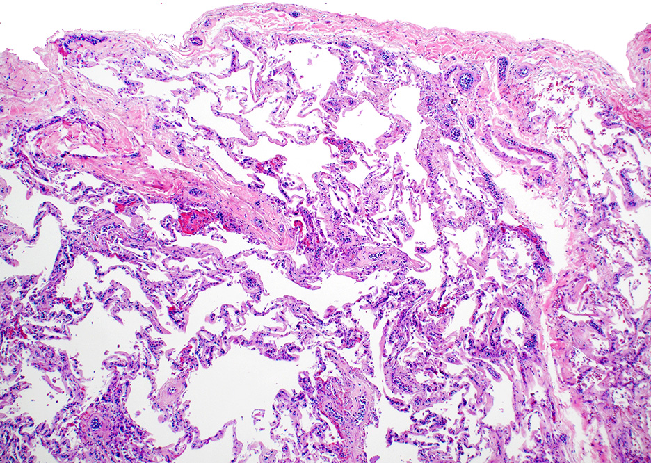 Pathology Outlines - Intravascular large B cell lymphoma