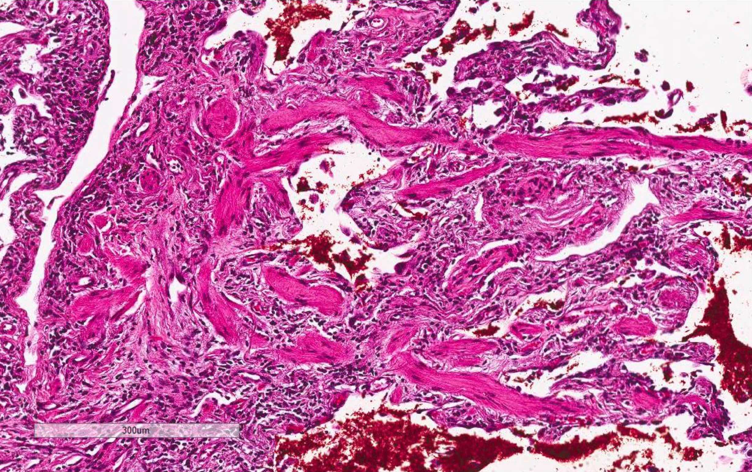 Acute Interstitial Pneumonia