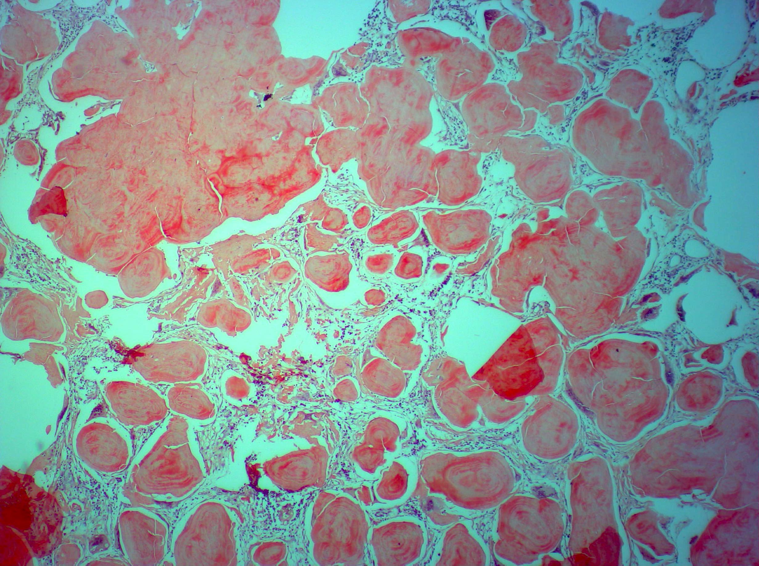 Pathology Outlines - Nodular amyloid (amyloidoma)