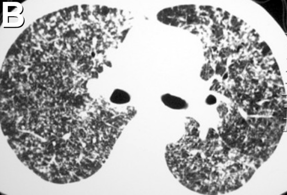 Pathology Outlines - Histoplasma