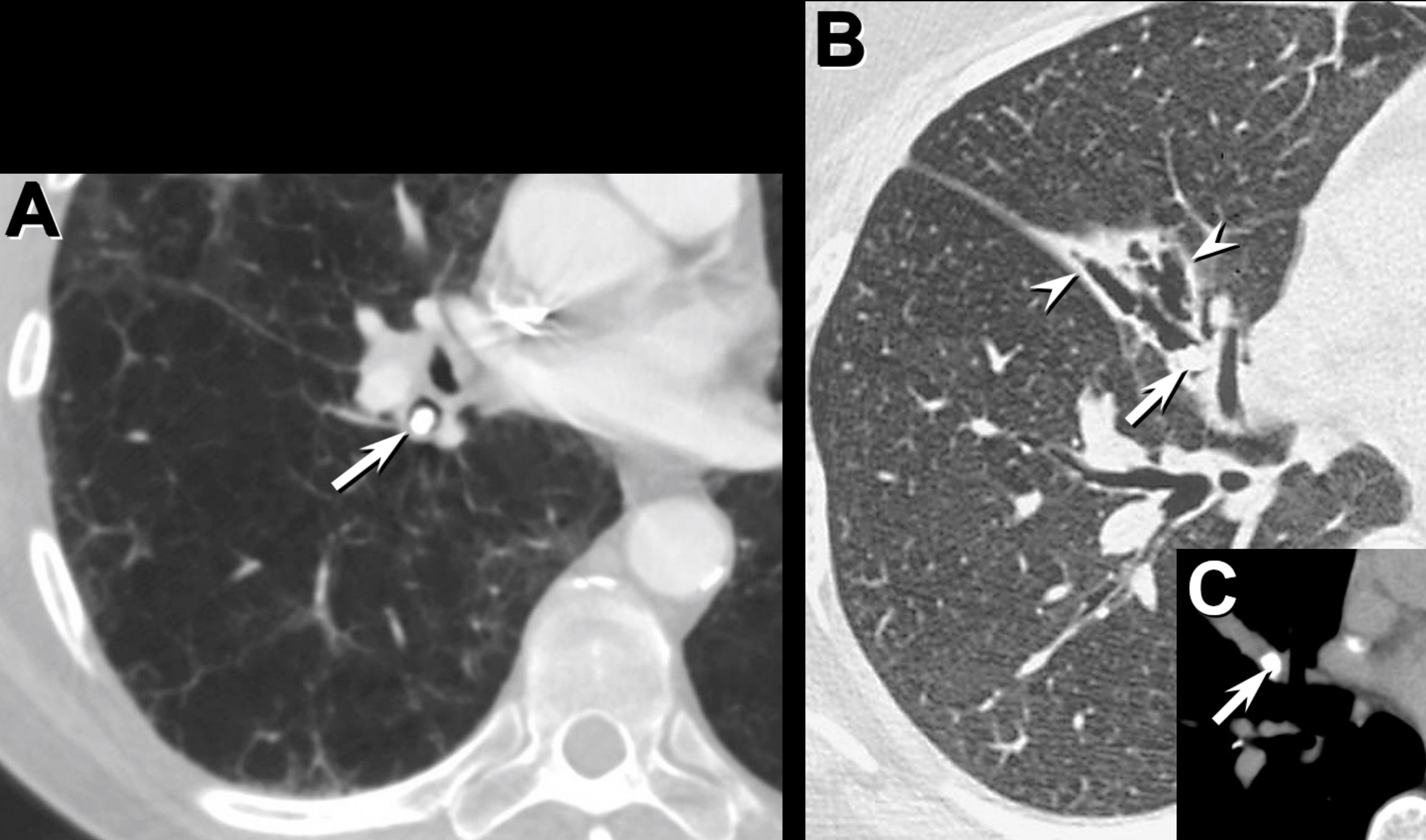 Pathology Outlines - Histoplasma