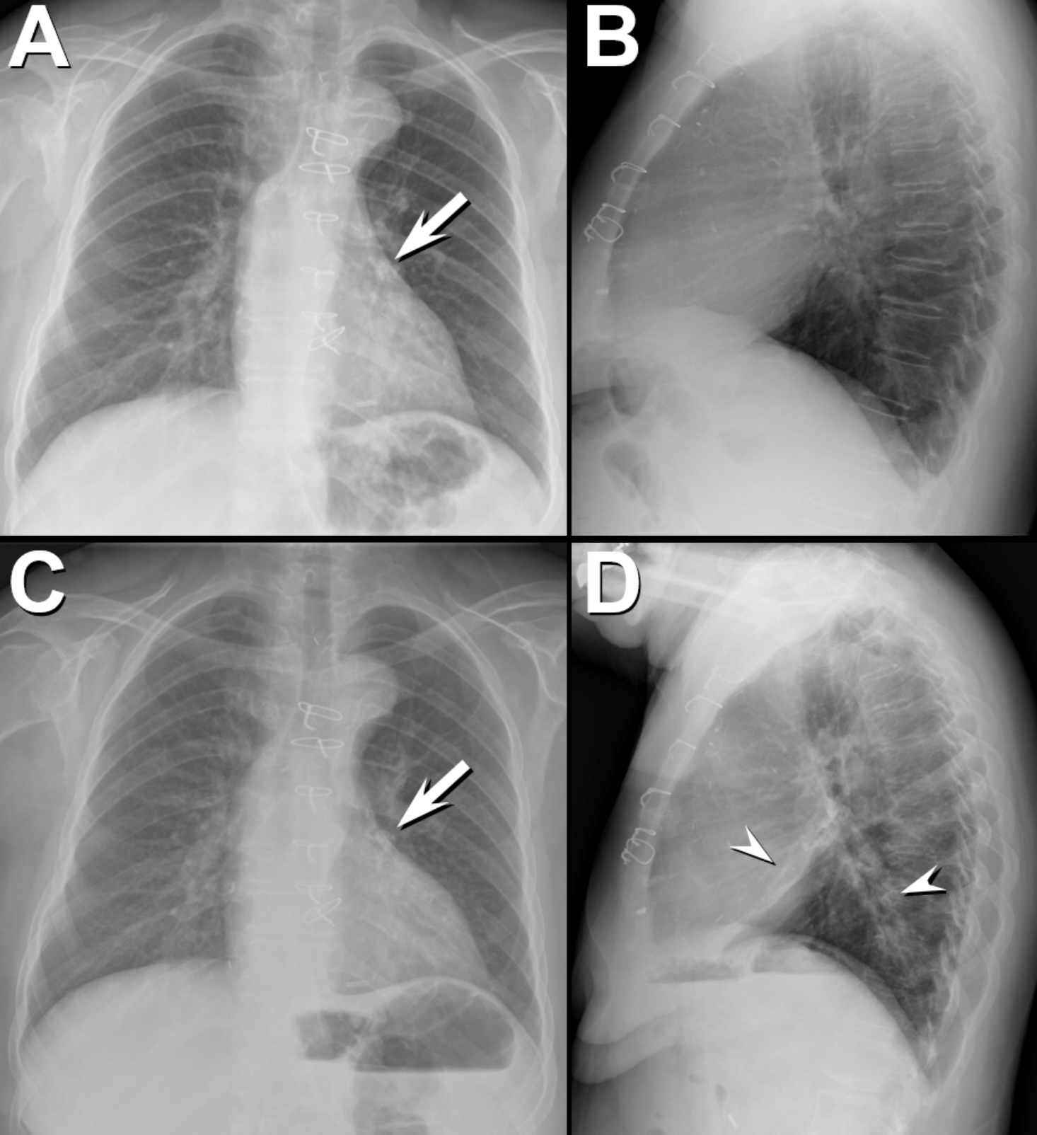 Pathology Outlines - Histoplasma