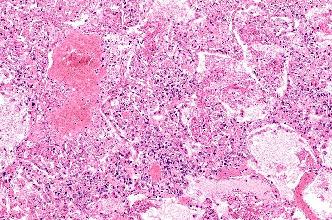 Pathology Outlines - Histoplasma