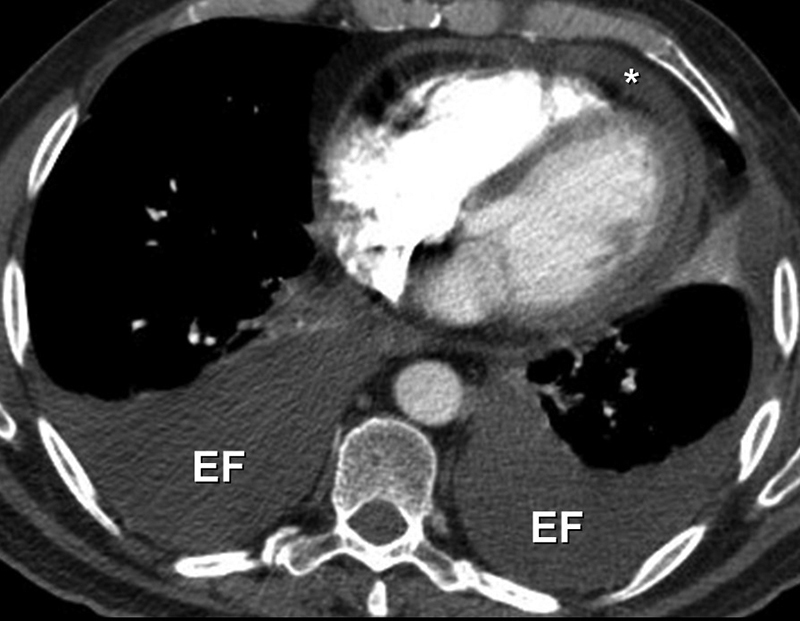 Pathology Outlines - Rheumatoid lung disease