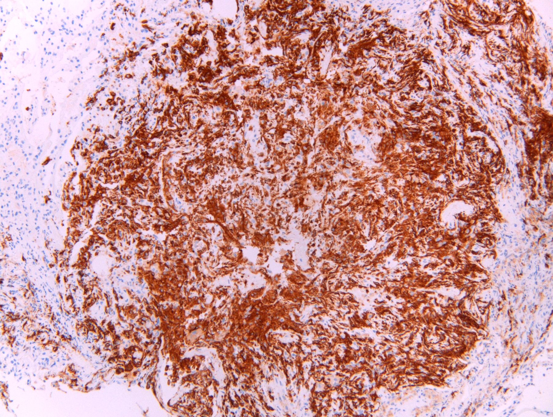 Pathology Outlines - Langerhans cell histiocytosis