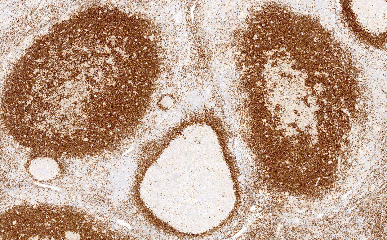 Pathology Outlines - Progressive transformation of germinal centers
