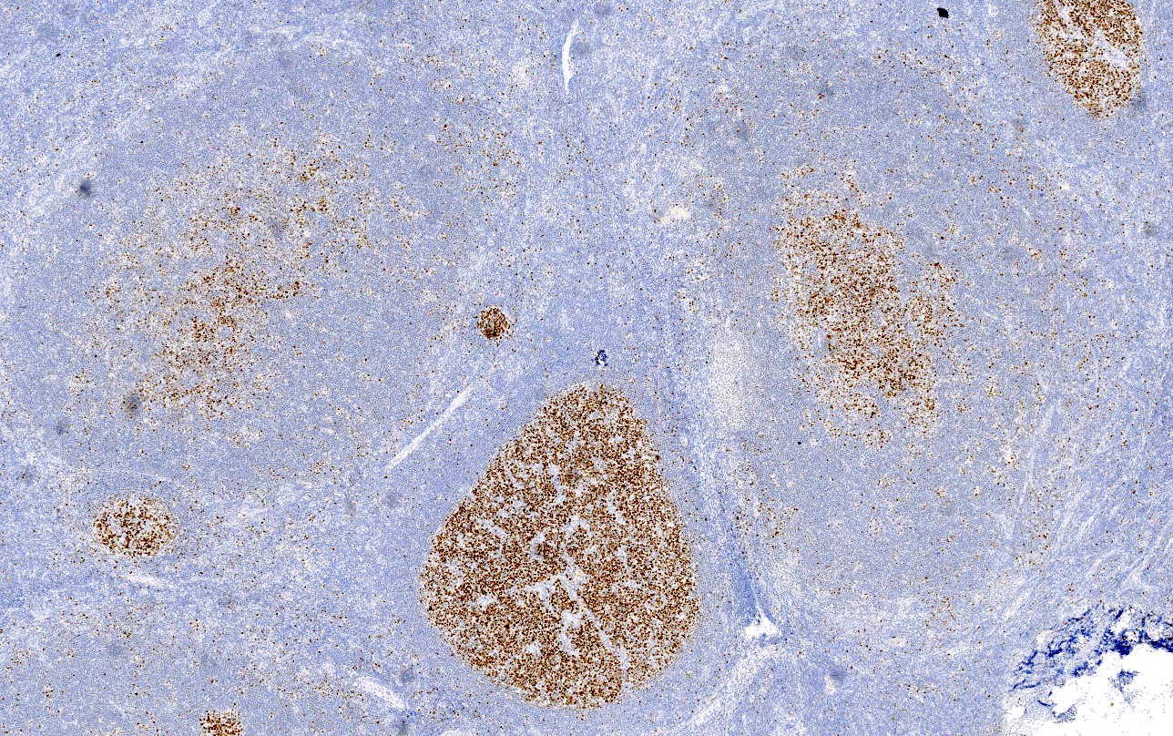 Pathology Outlines - Progressive transformation of germinal centers