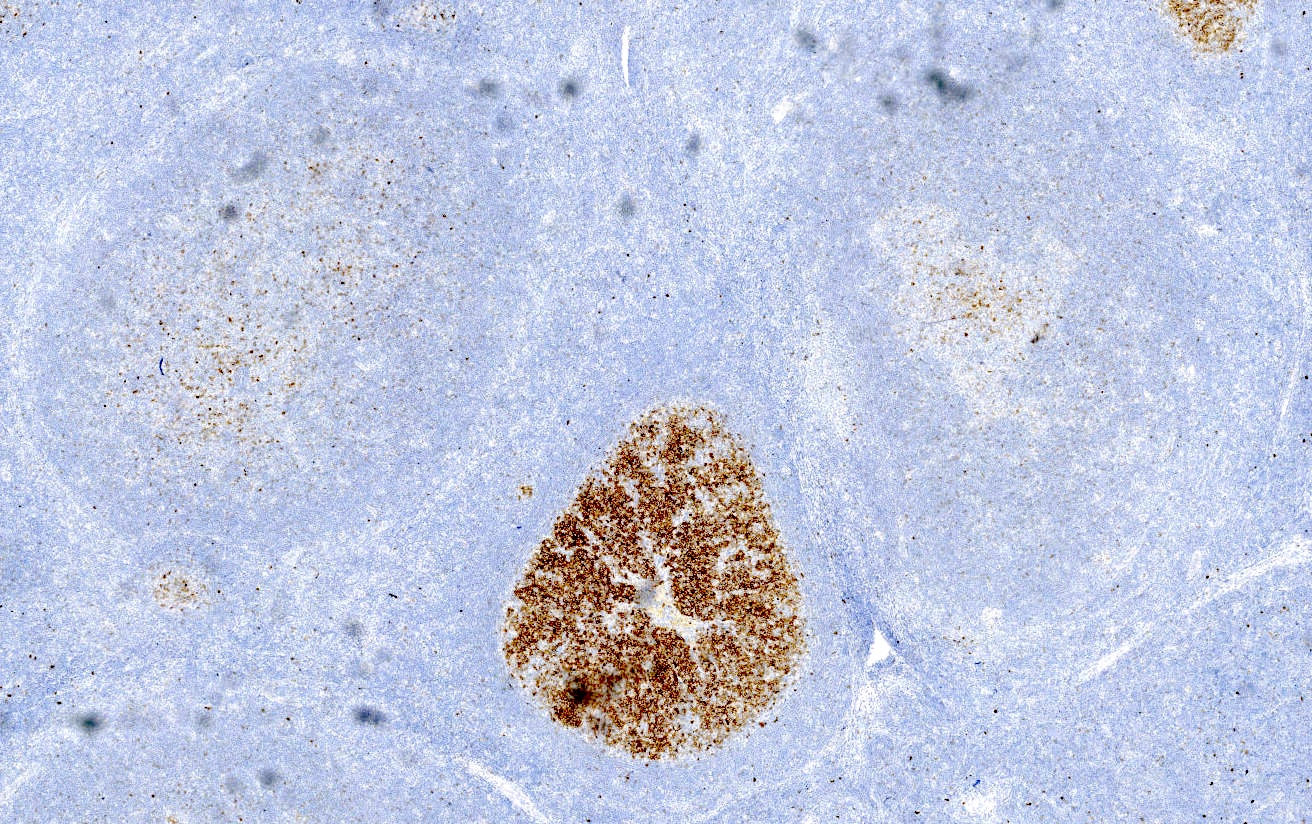 Pathology Outlines - Progressive transformation of germinal centers