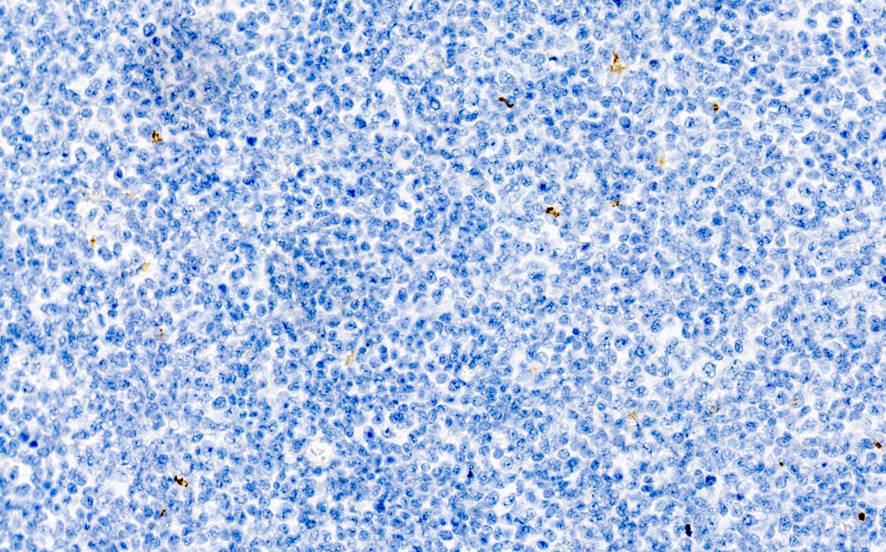 Pathology Outlines - Progressive transformation of germinal centers