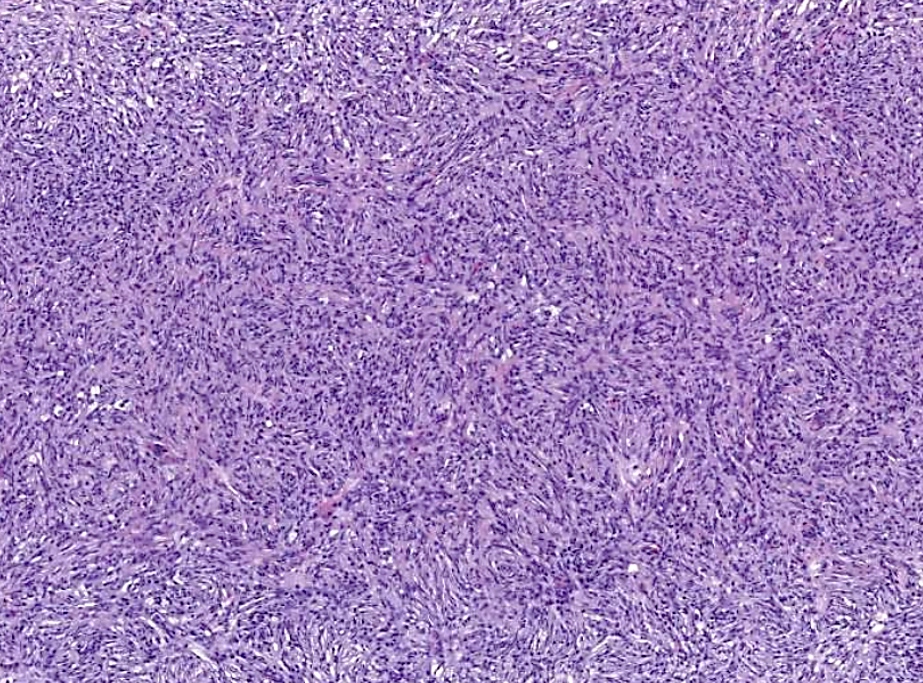 Pathology Outlines - ALK+ histiocytosis