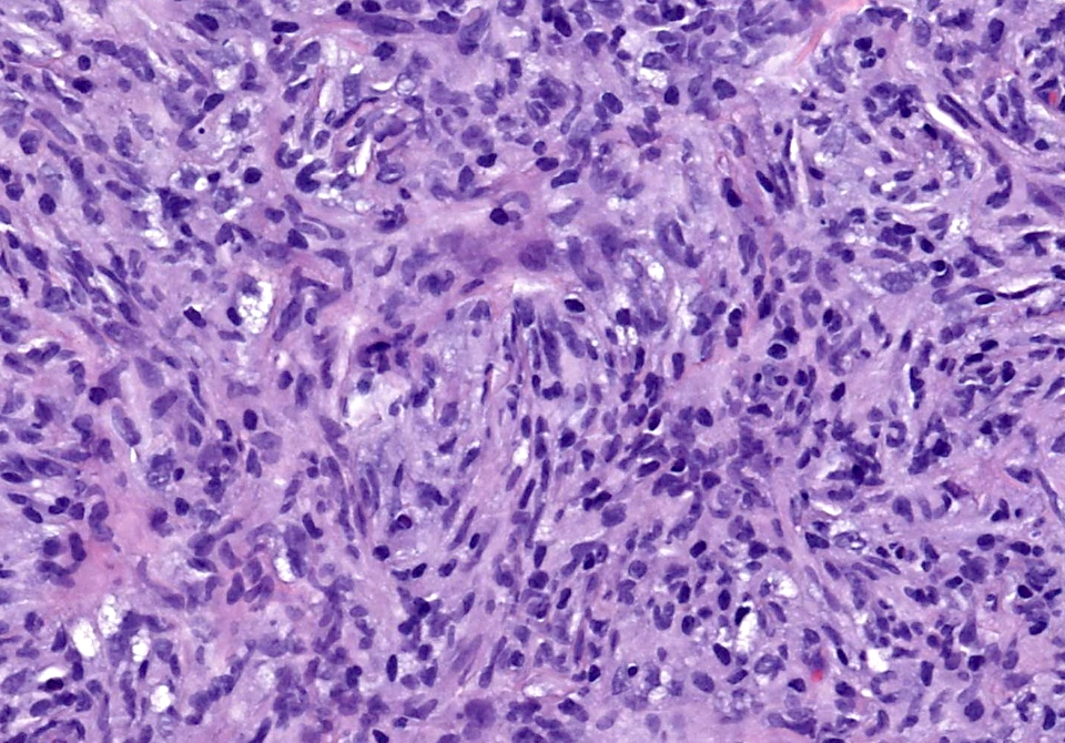 Pathology Outlines - ALK+ histiocytosis