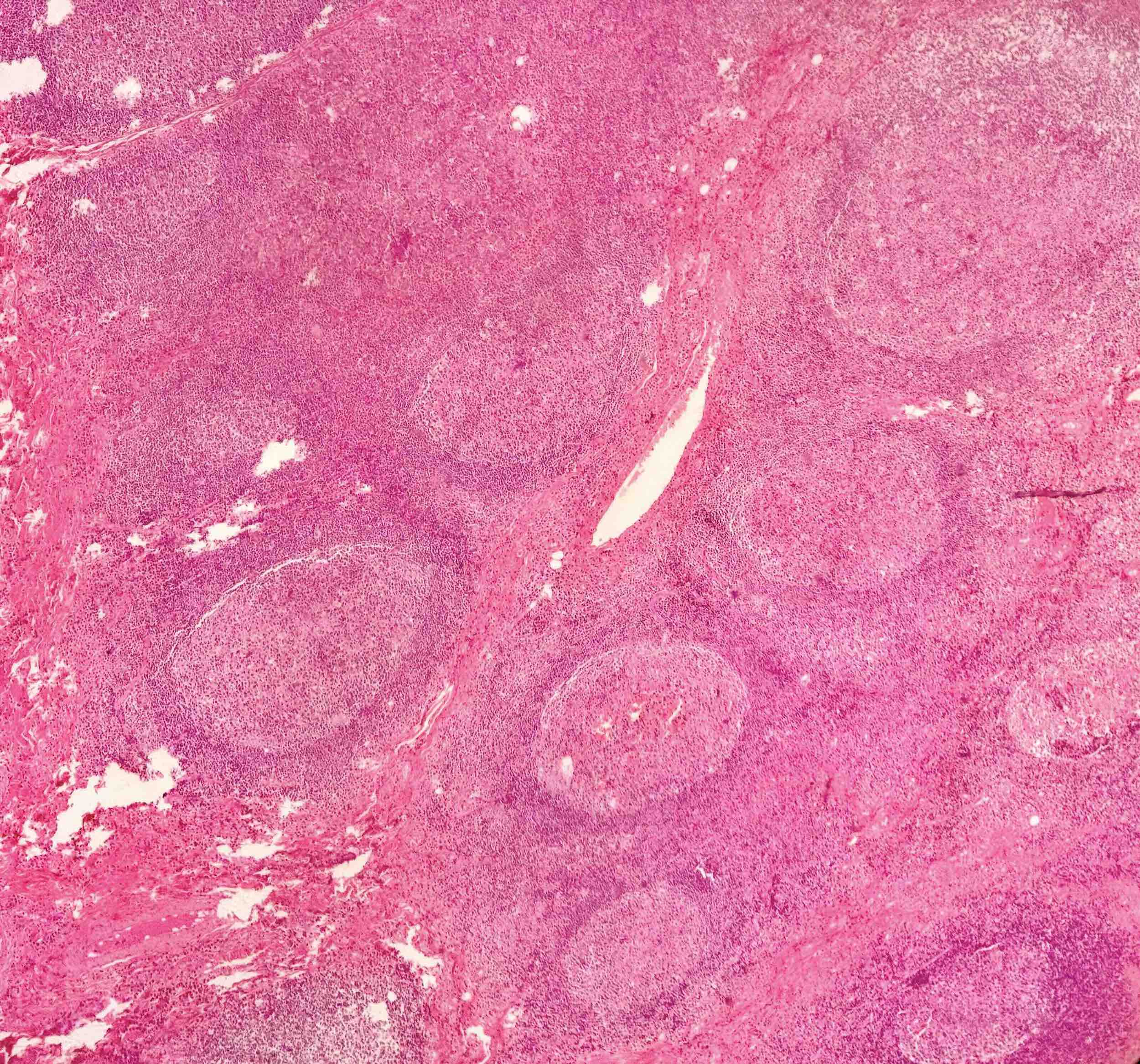 Pathology Outlines Eosinophils Pathology Outlines Chronic