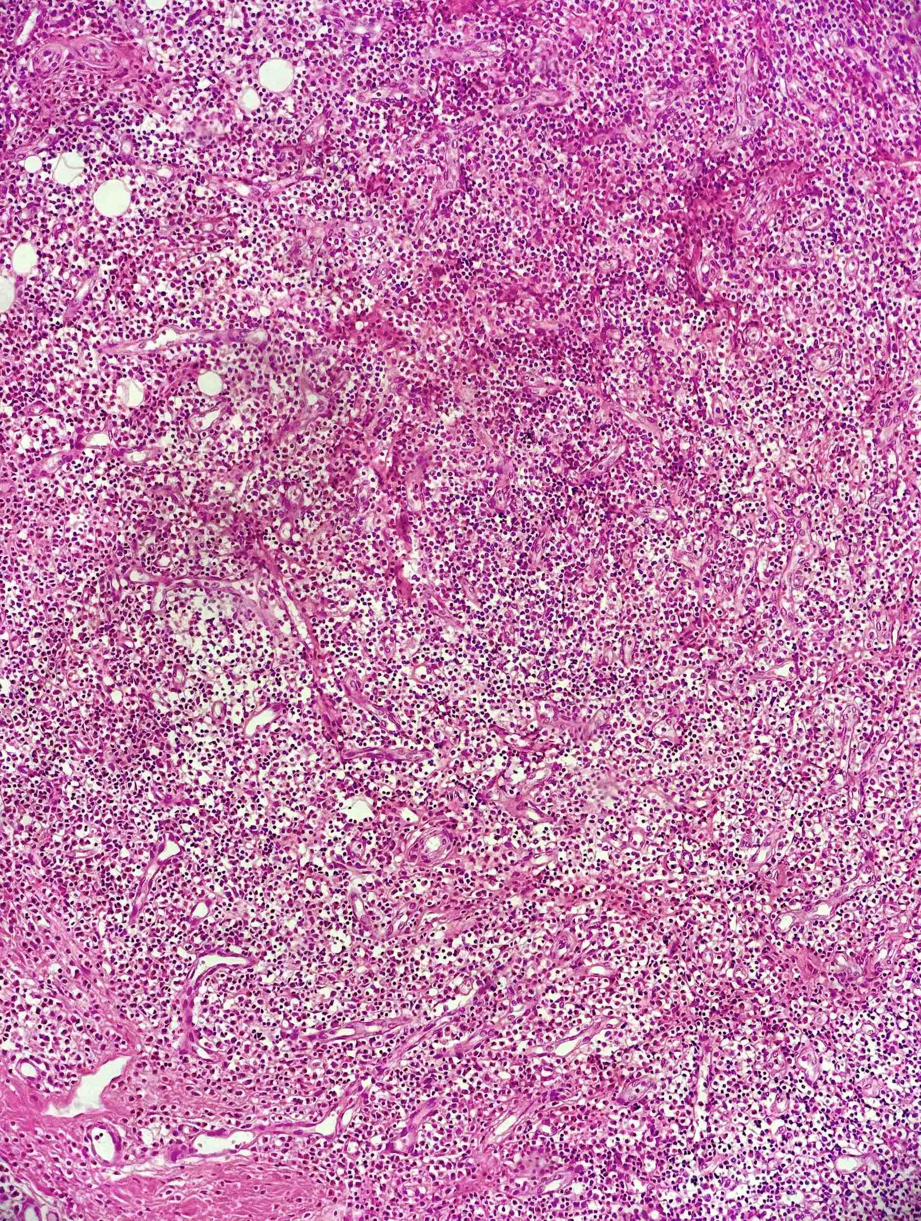 Pathology Outlines Eosinophils Pathology Outlines Chronic