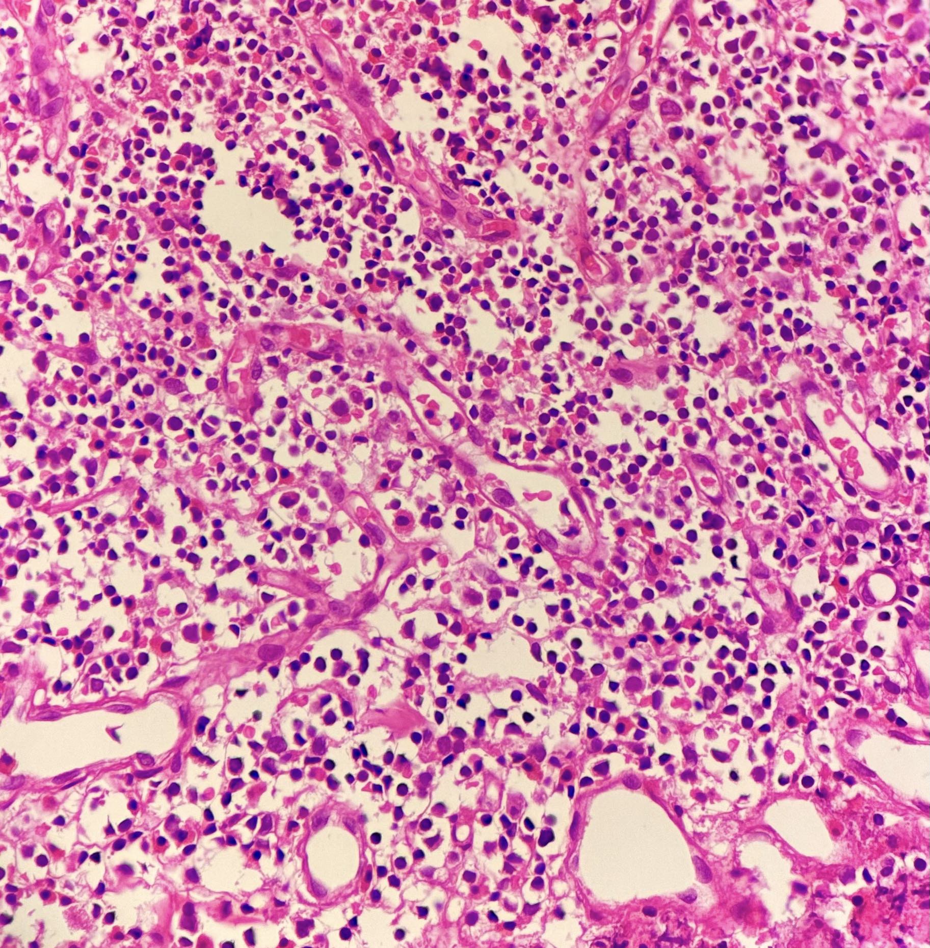 Pathology Outlines Eosinophils Pathology Outlines Chronic