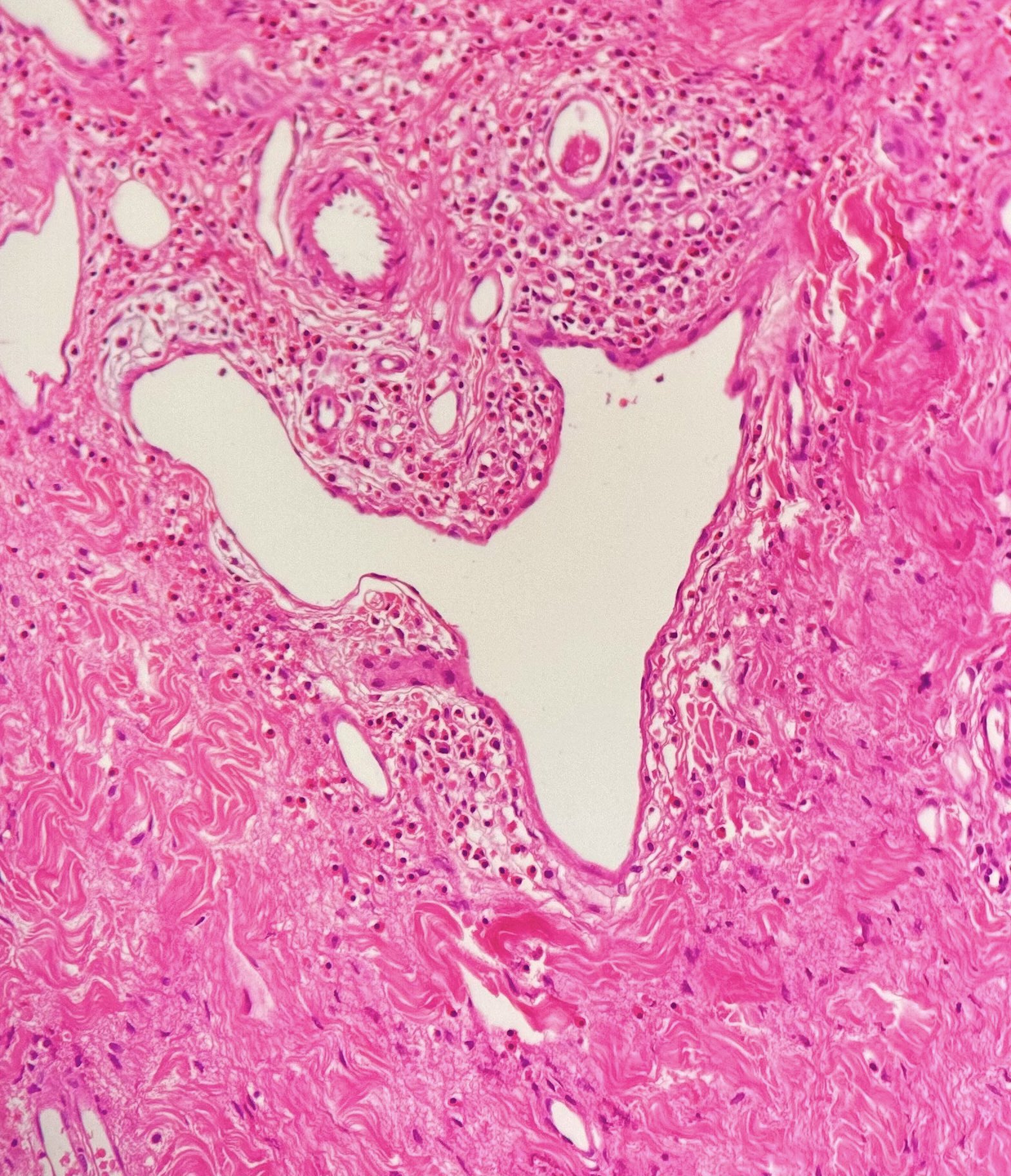 Pathology Outlines Eosinophils Pathology Outlines Eosinophils
