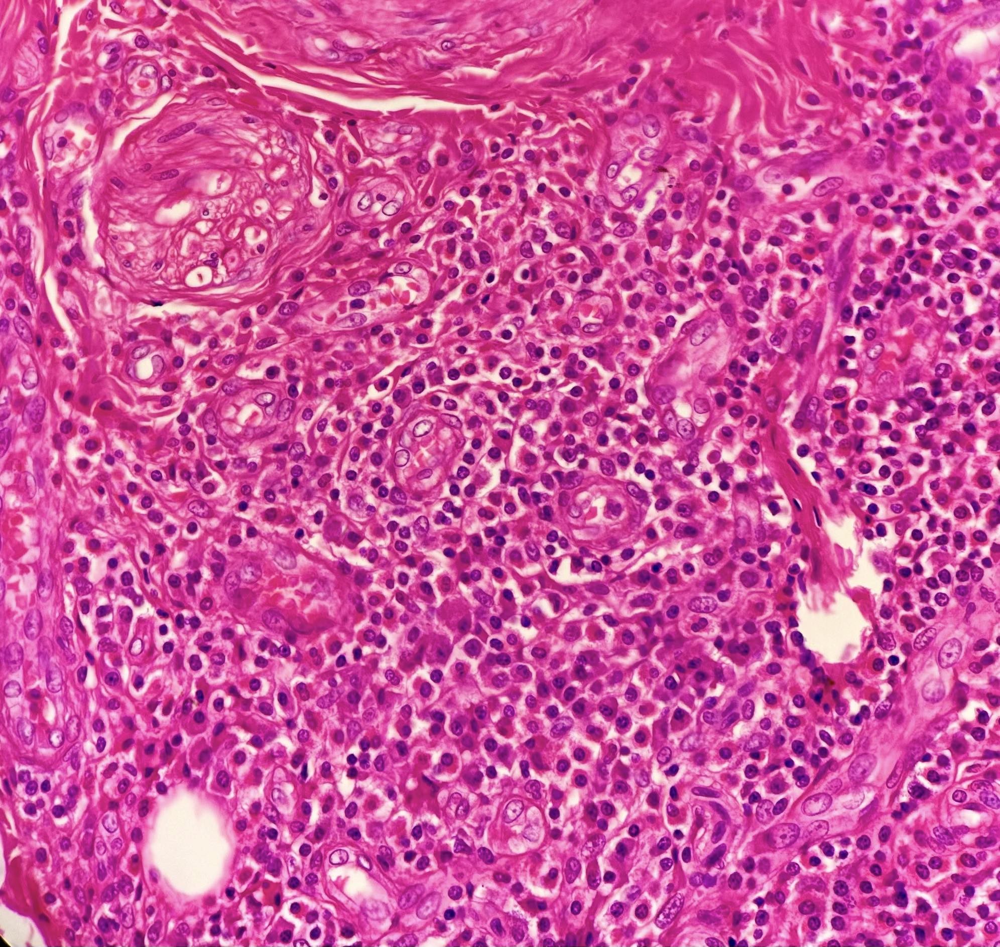 Pathology Outlines Eosinophils Pathology Outlines Eosinophils