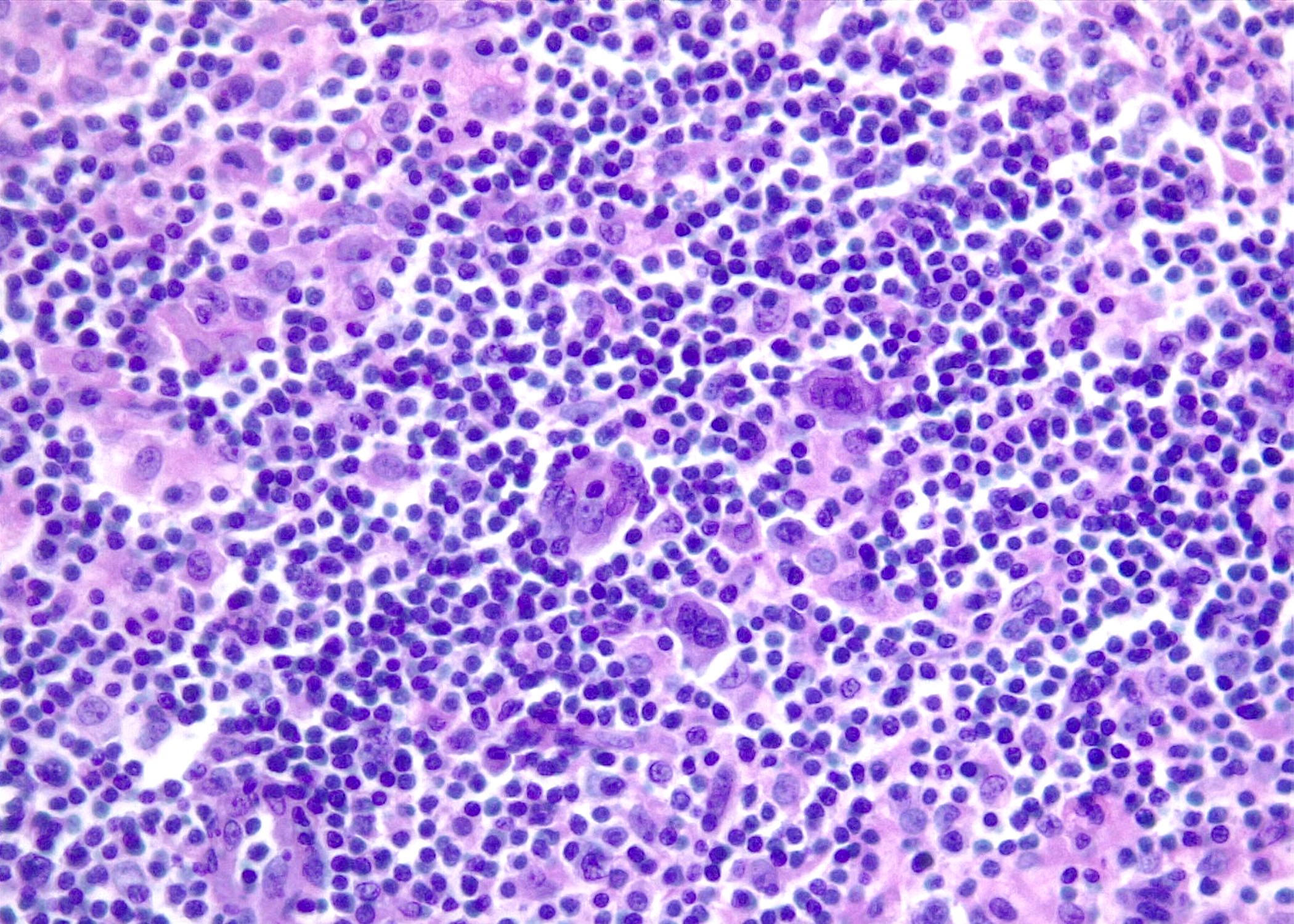 Pathology Outlines - EBV related lymphoid proliferations