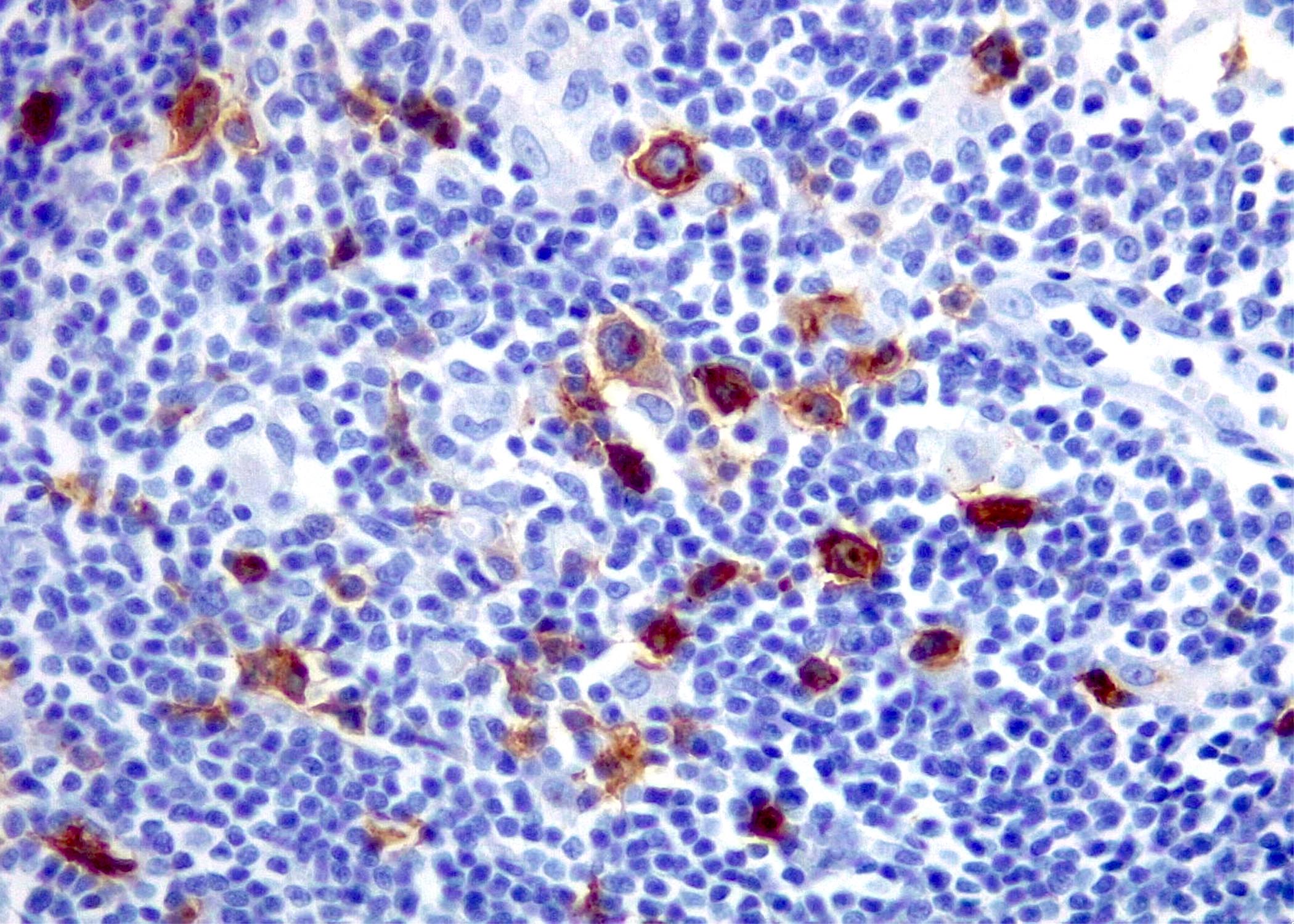 Pathology Outlines - EBV related lymphoid proliferations