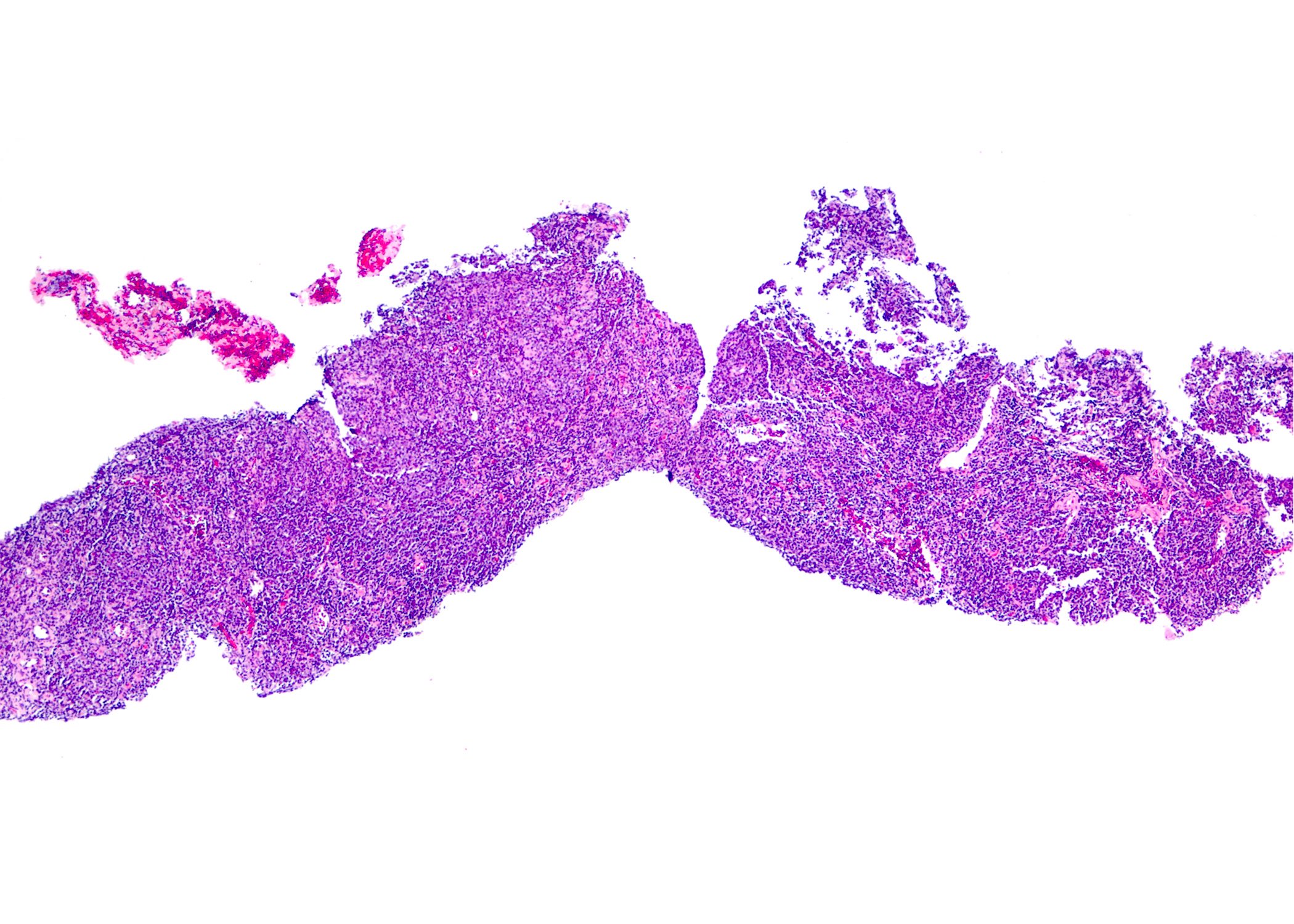 Pathology Outlines - EBV related lymphoid proliferations